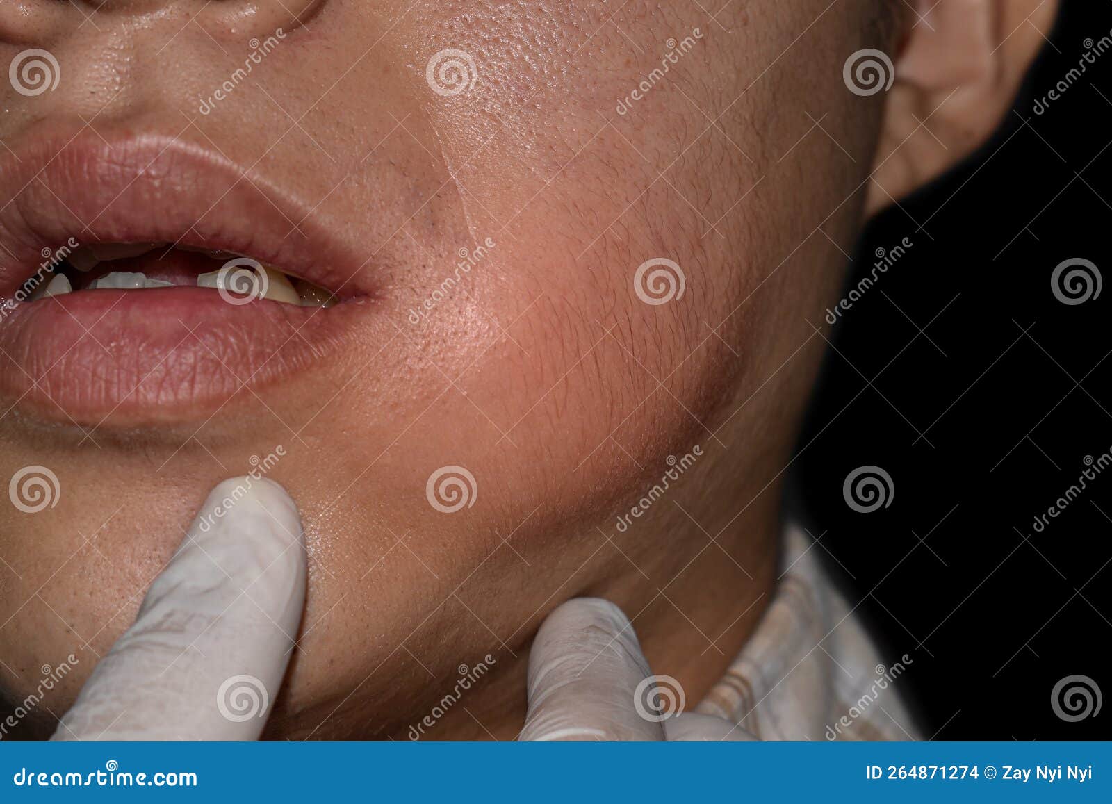 Abscess On Cheek