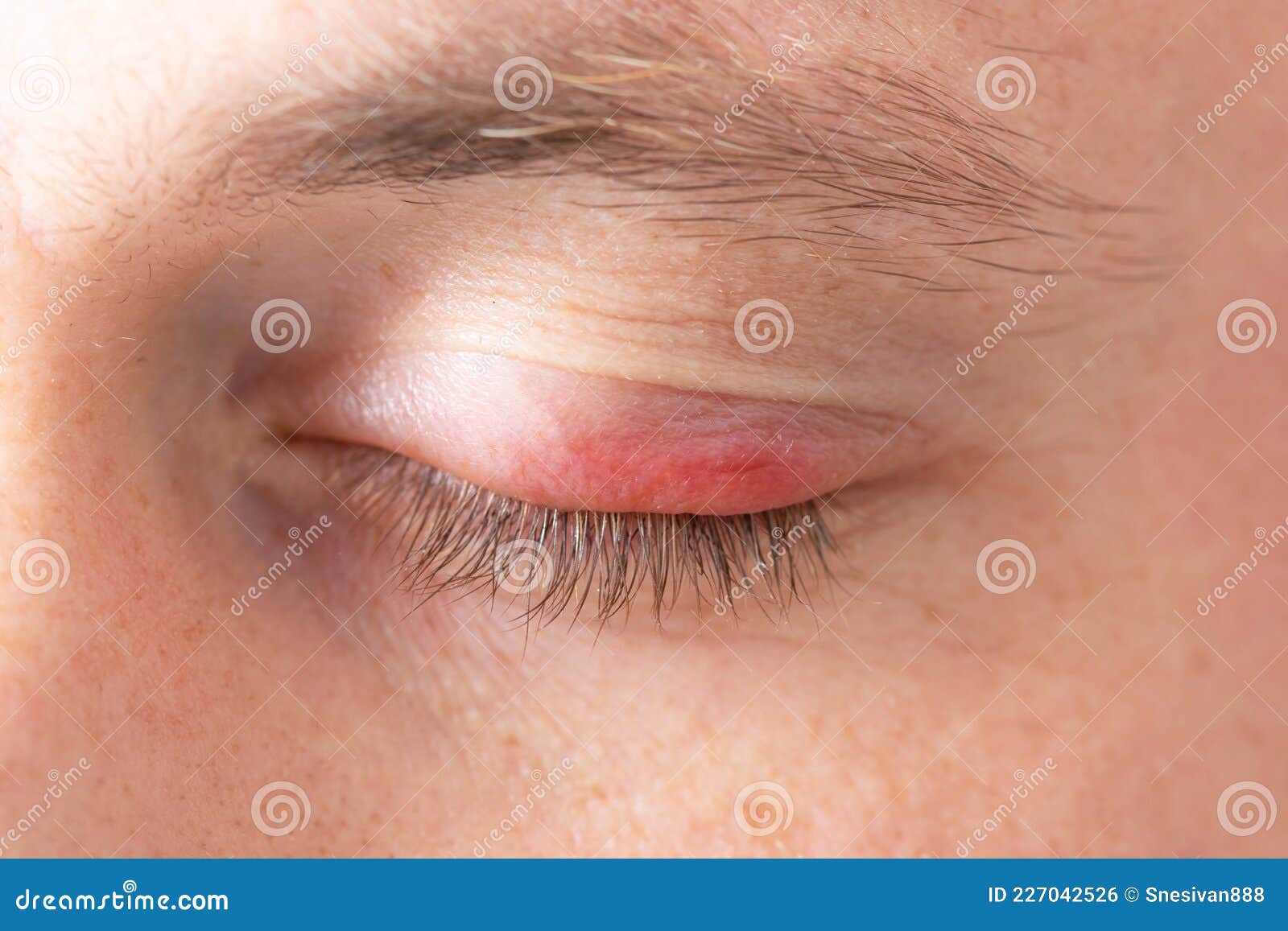 Swelling of the Eye. Swollen Upper Lid Stock Photo - Image of fatigue ...