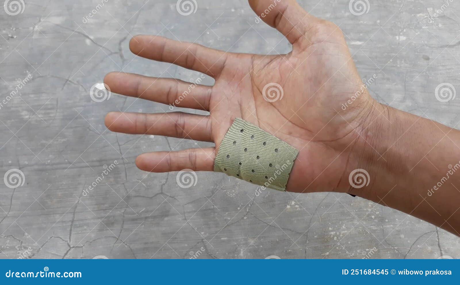 Swollen back of the palm stock video. Video of bitten - 251684545