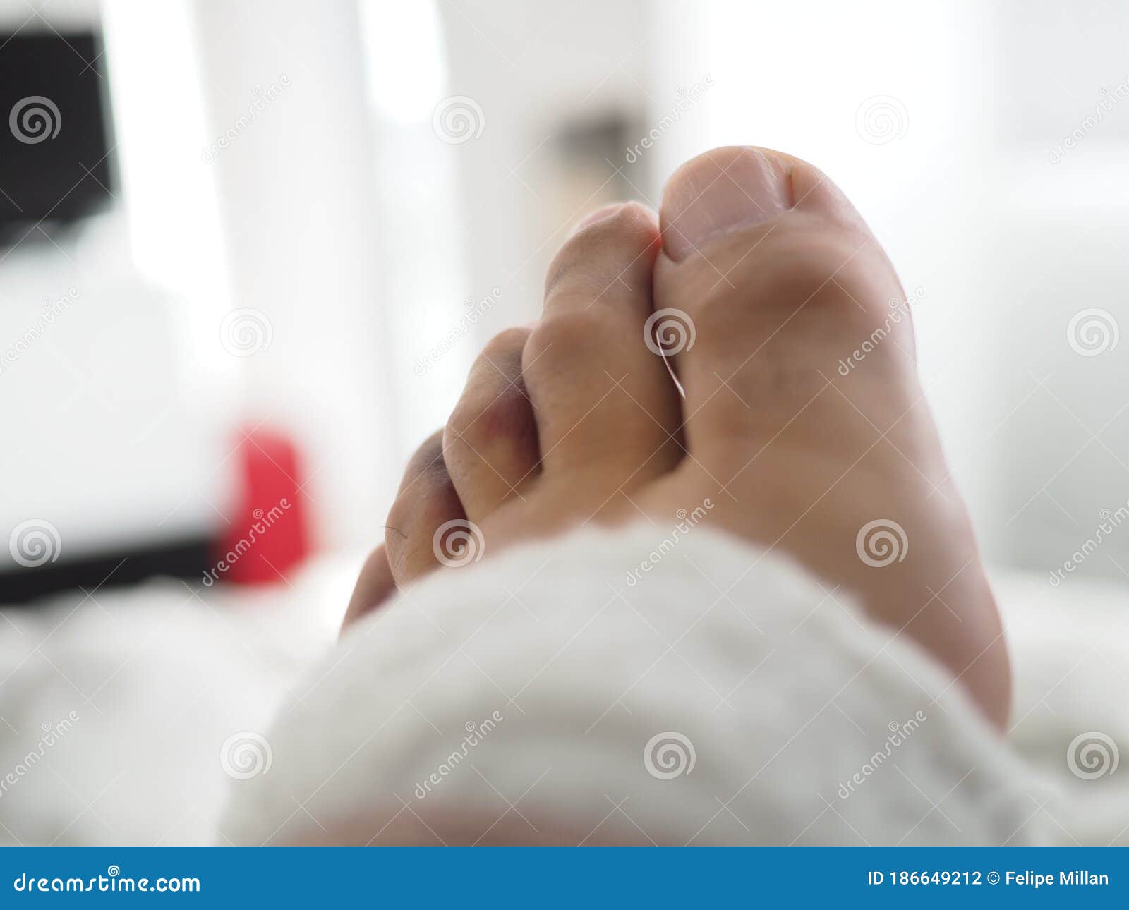 Bruised Feet Of An Elderly Woman. Hematome Large, Blue Foot. Trauma Of ...