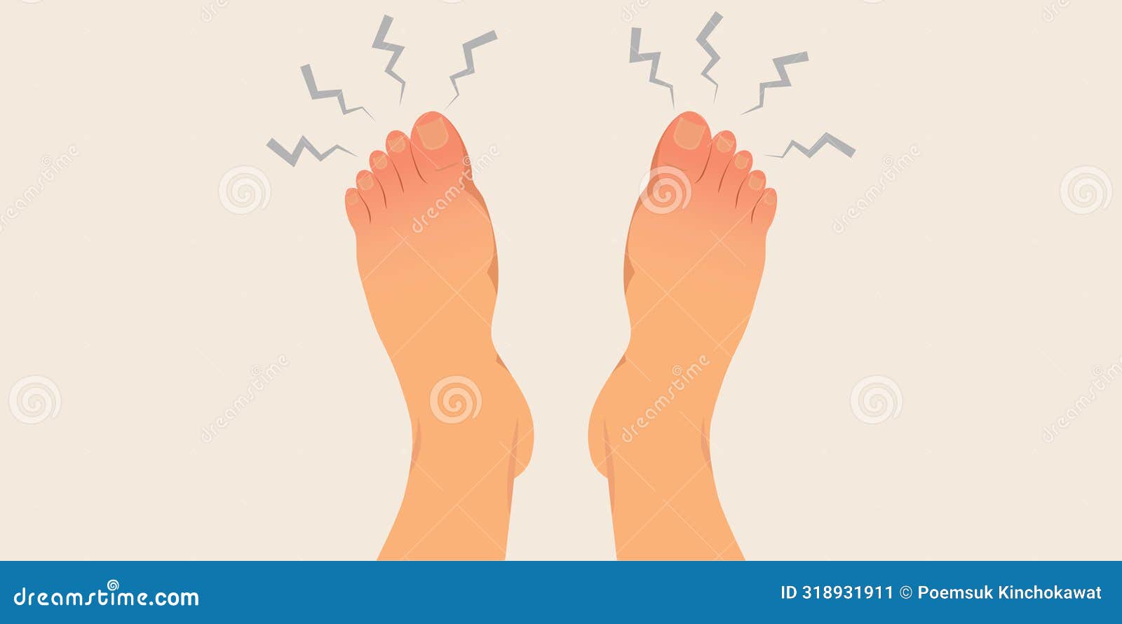 Swollen Feet Or Numb Feet Feeling Tingly Stock Vector Illustration Of Swell Albumin 318931911