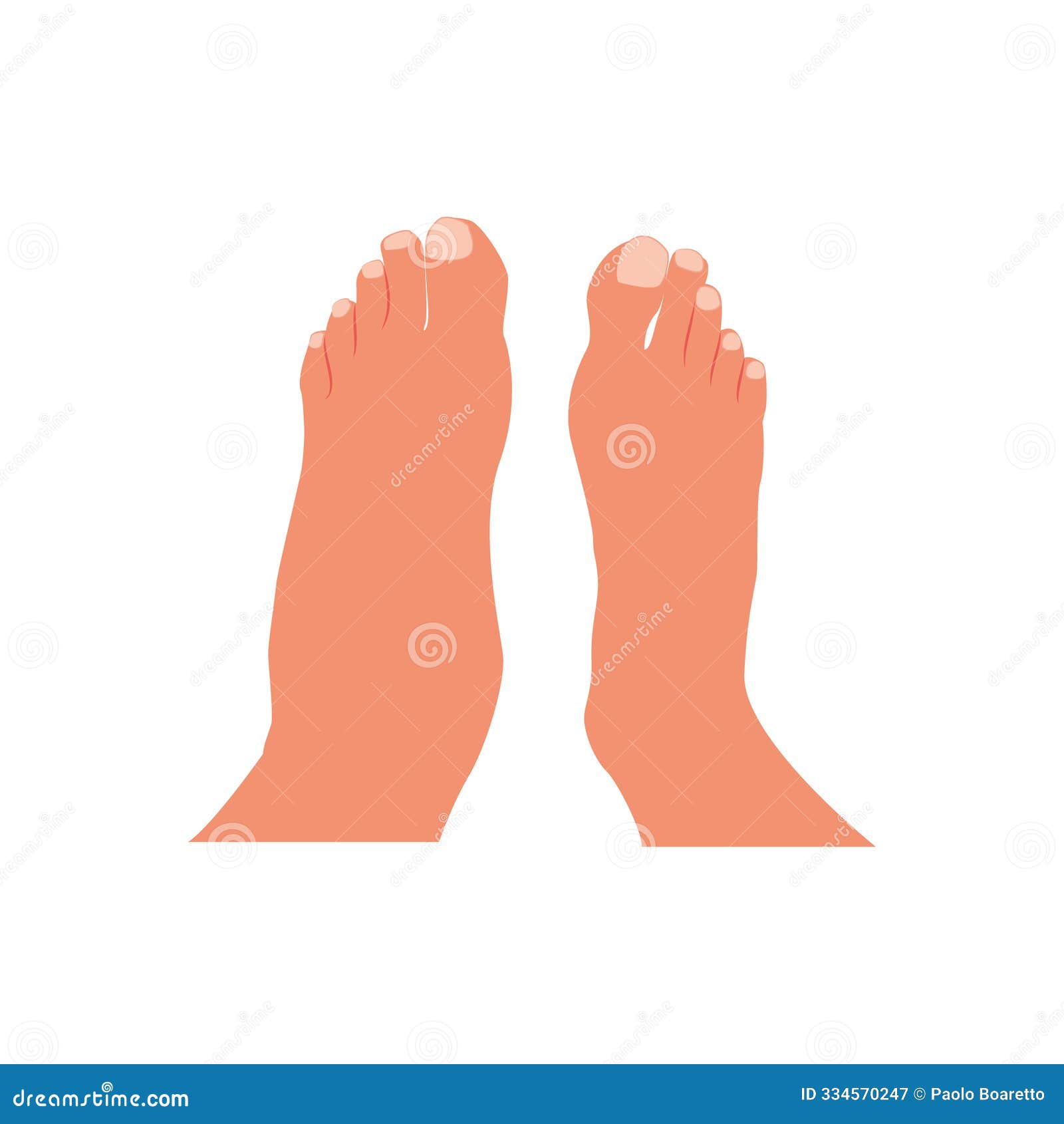 Swollen Foot, Normal Foot. before, after. Healthcare Illustration ...