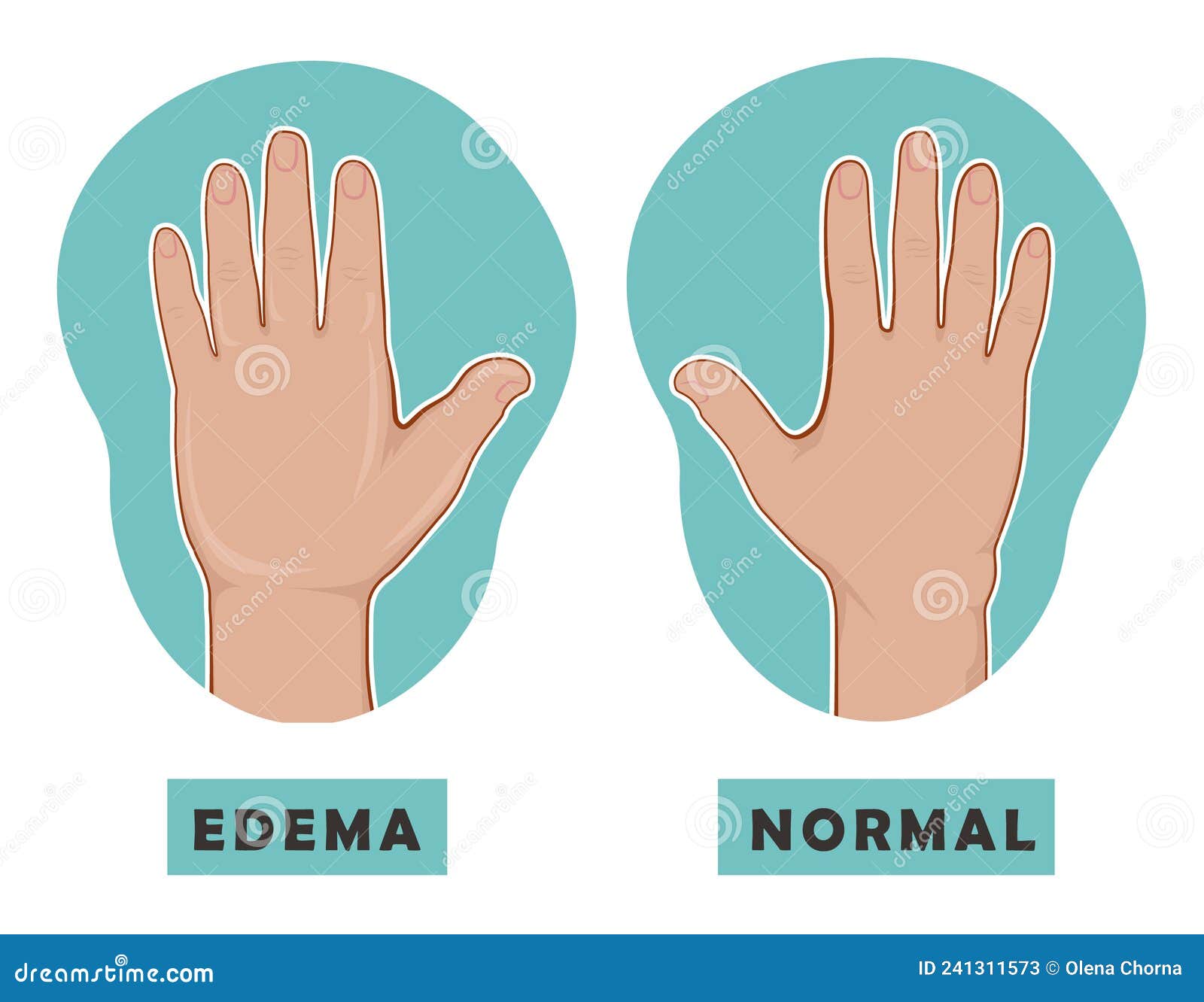 Swollen Hand and Normal Hand. Edema and Lymphedema. Vector Illustration ...