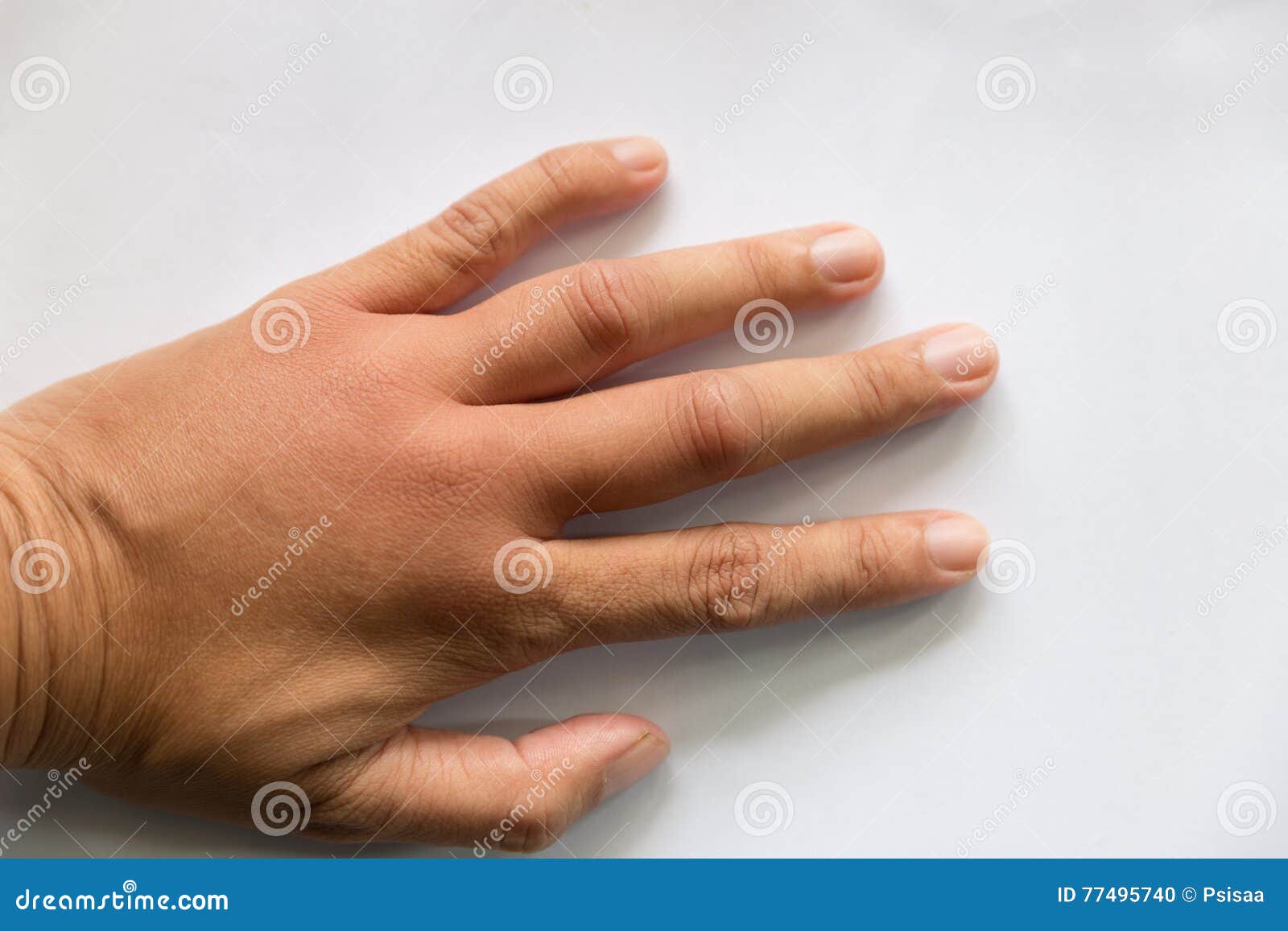 Swollen Hand Stock Photo | CartoonDealer.com #26329254