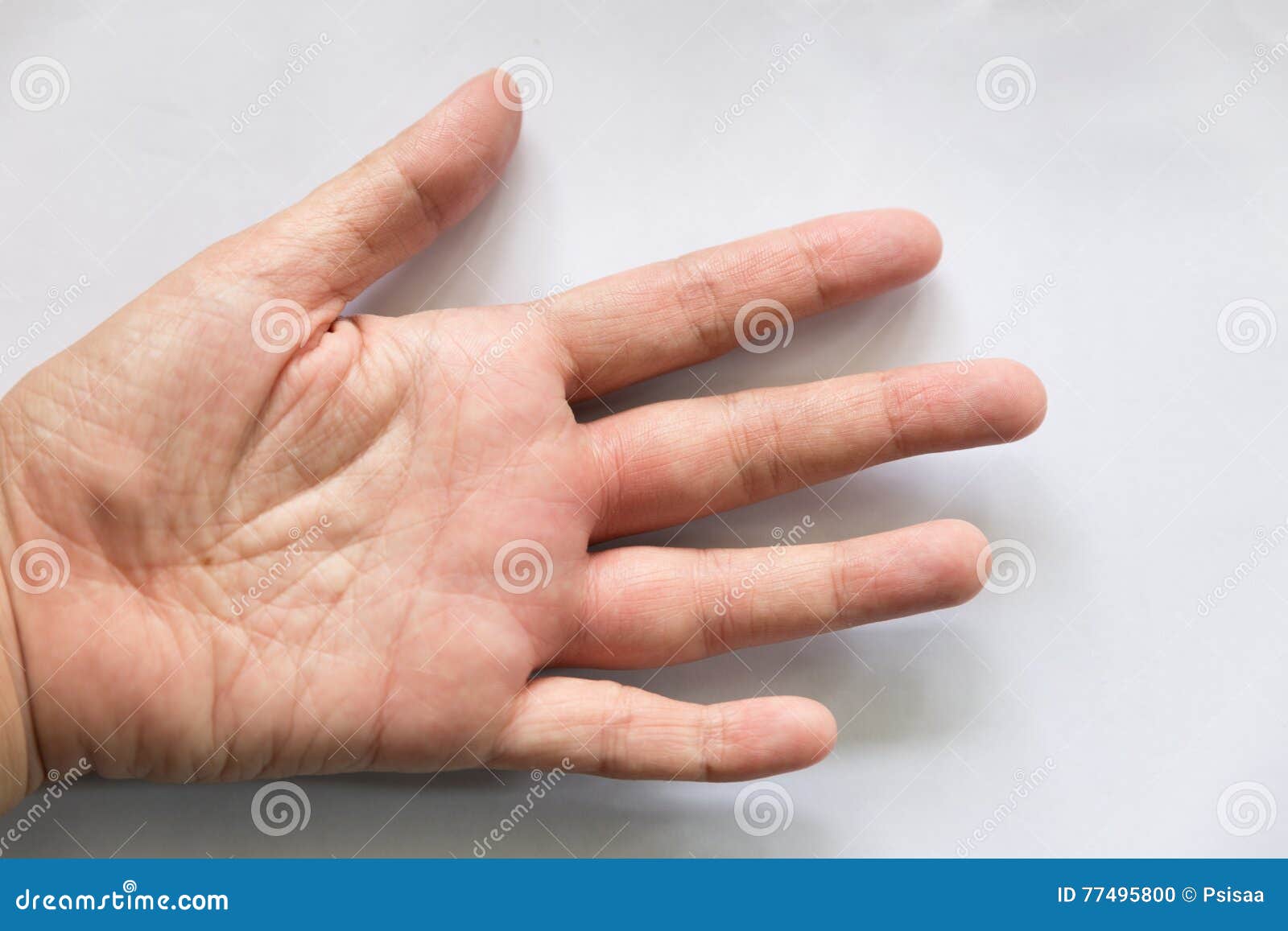 Swollen Hand Stock Photo | CartoonDealer.com #26329254