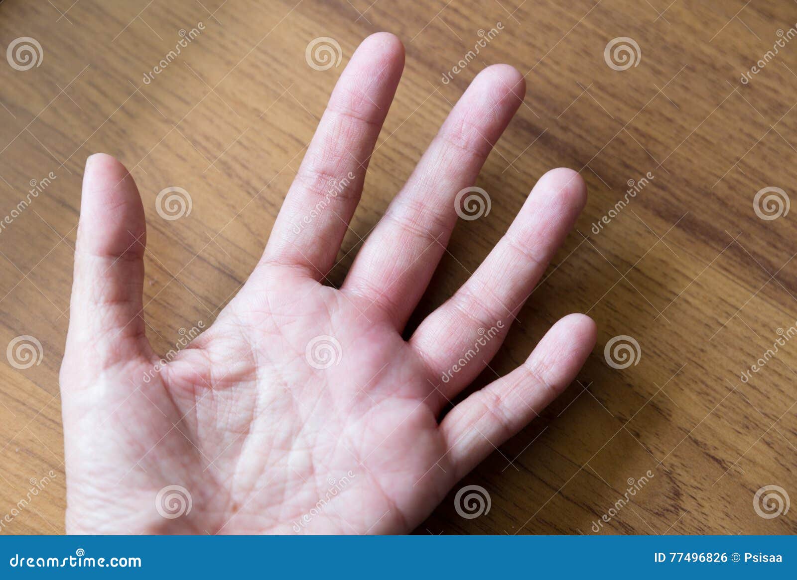 Swollen Hand Stock Photo | CartoonDealer.com #26329254