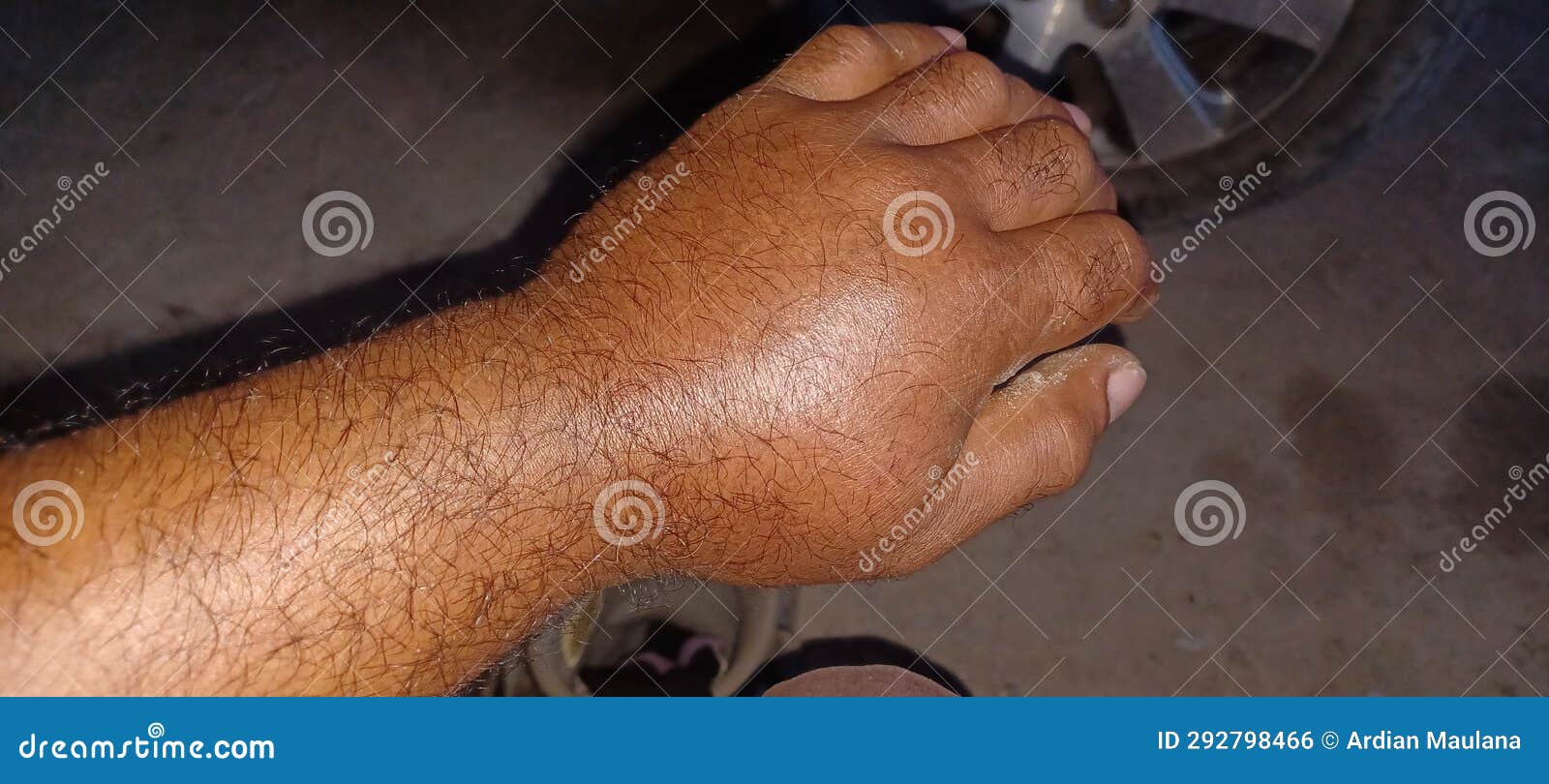 Swollen hands stock photo. Image of hand, face, swollen - 292798466