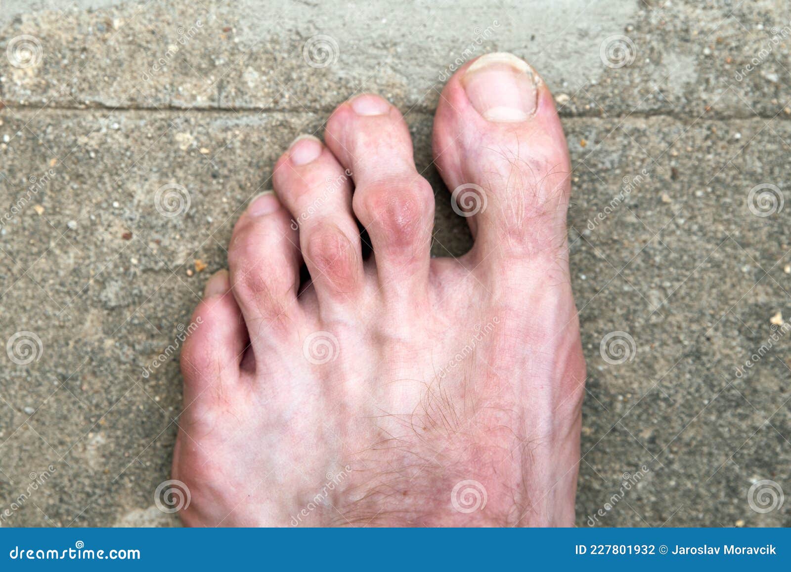 Swollen Joint on the Toe. Rheumatoid Arthritis Stock Photo - Image of ...