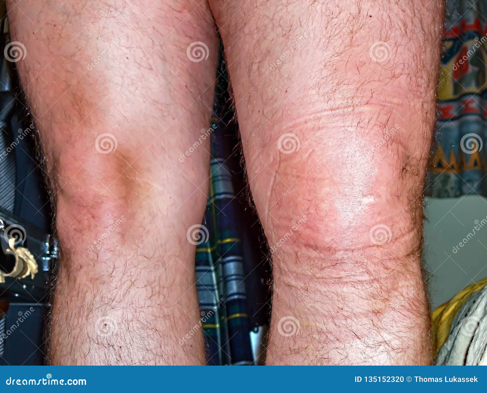 Knee Inflammation Swelling