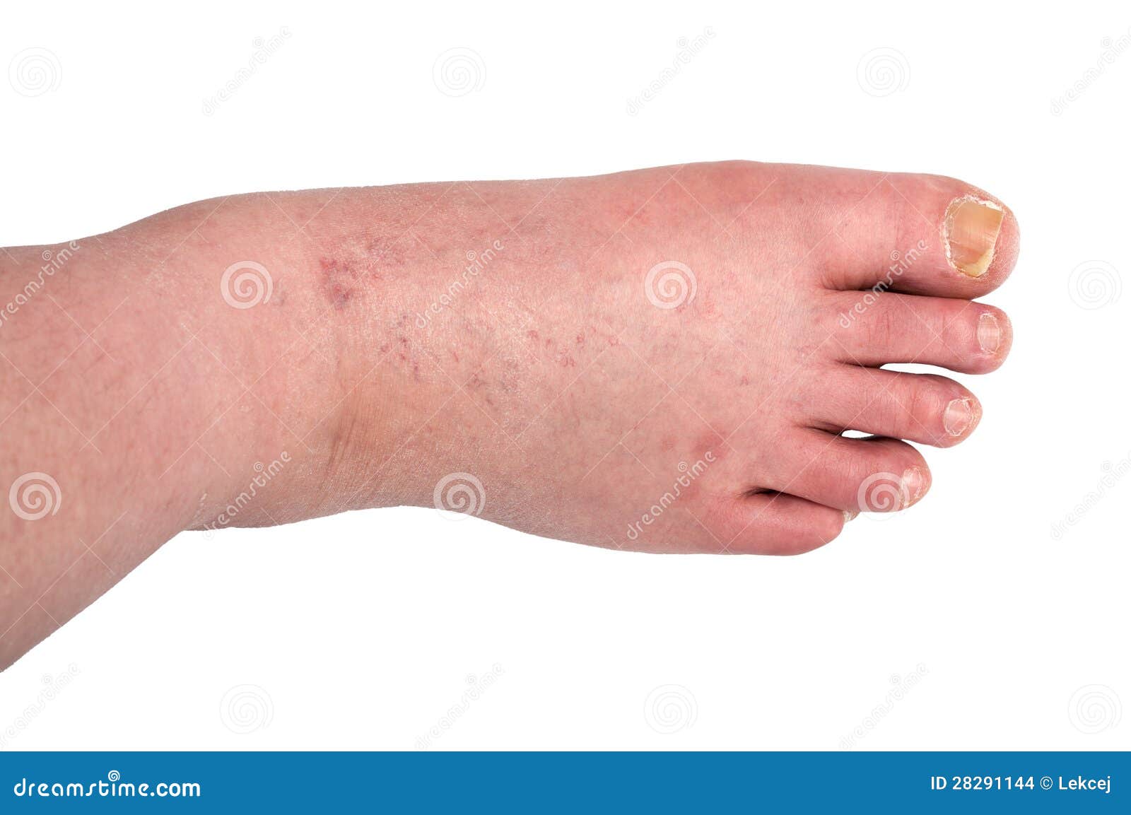 Swollen Leg Stock Photos - Royalty Free Pictures