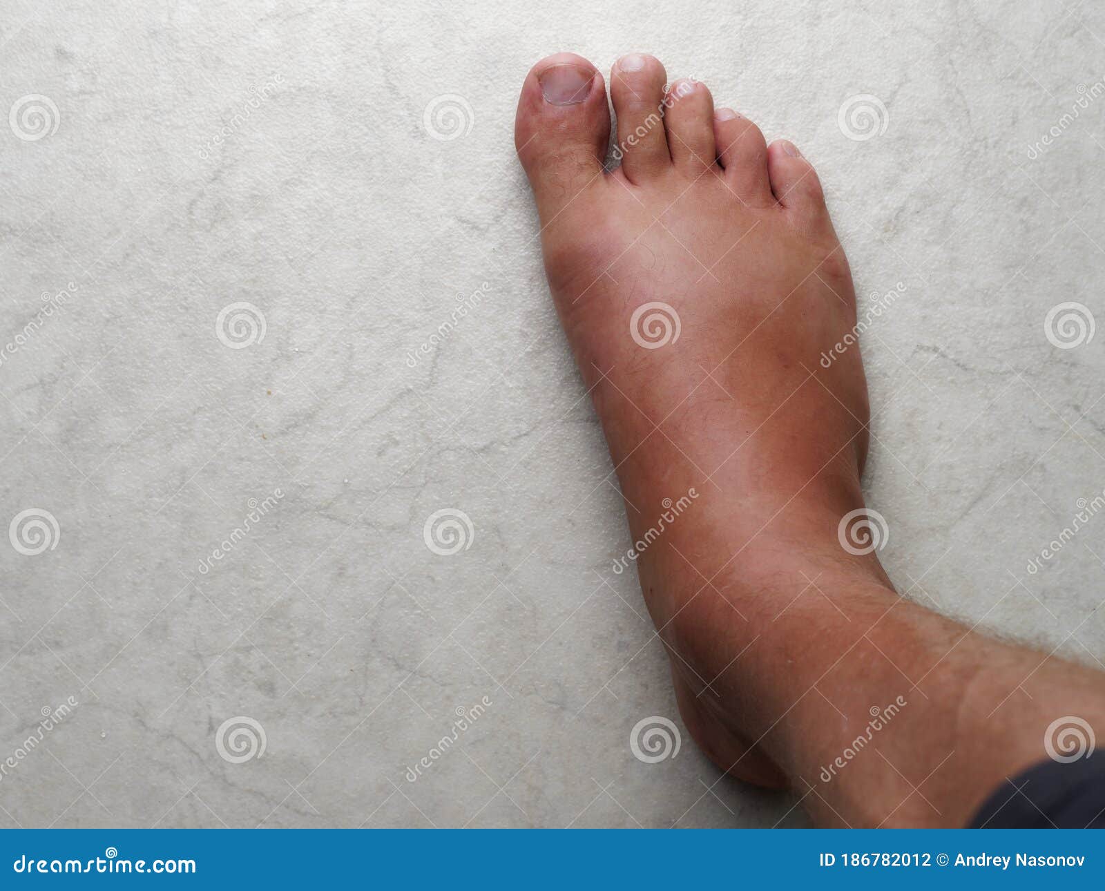 Swollen Leg after a Wasp Bite. Stock Photo - Image of indoor, bruise ...