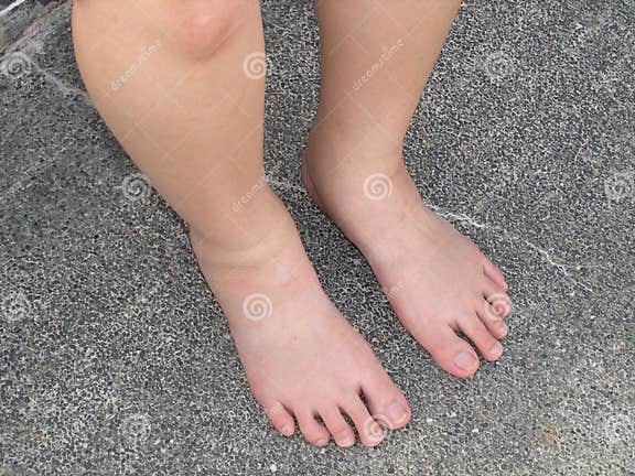 Swollen Legs stock image. Image of swollen, legs, foot - 746723
