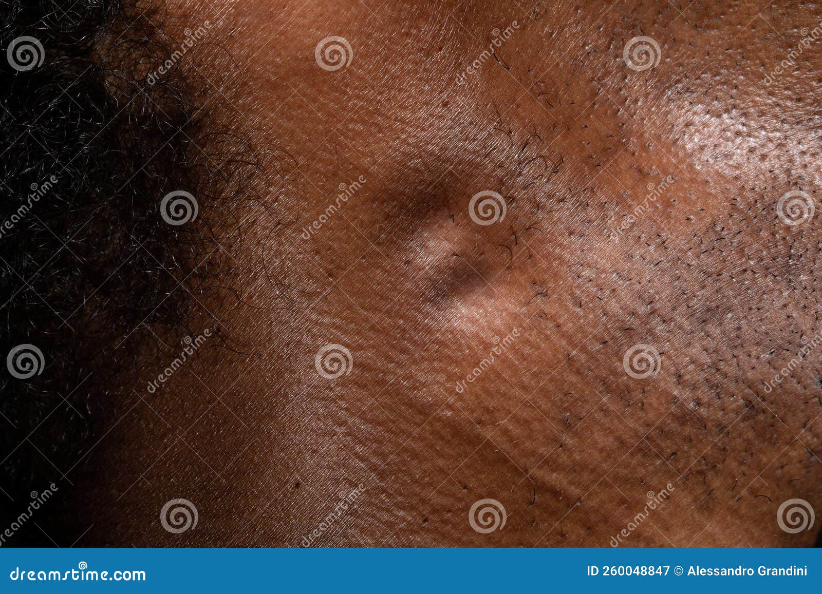 Swollen Lymph Nodes in the Neck of an African Man Stock Image - Image ...
