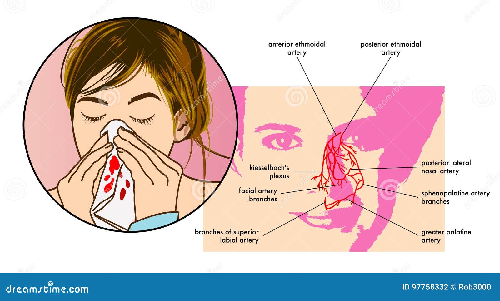 Symptômes d'Epistaxis illustration de vecteur. Illustration du soin - 97758332
