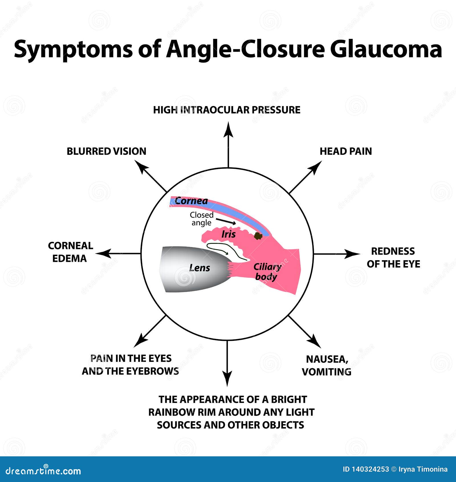 The Symptoms Of Closed Angle Glaucoma. World Glaucoma Day. The ... The Symptoms Of Closed Angle Glaucoma. World Glaucoma Day. The ...