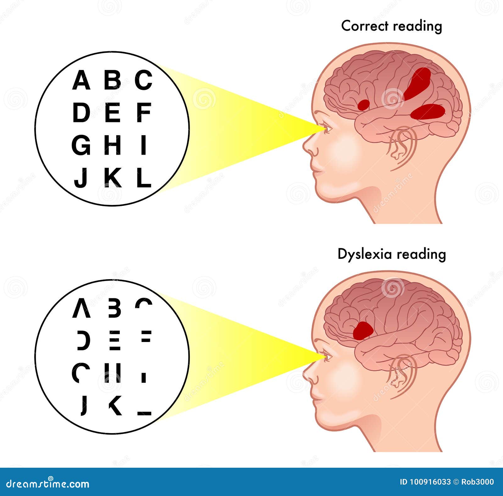 Symptoms of dyslexia stock vector. Illustration of circles - 100916033 Symptoms of dyslexia stock vector. Illustration of circles - 100916033
