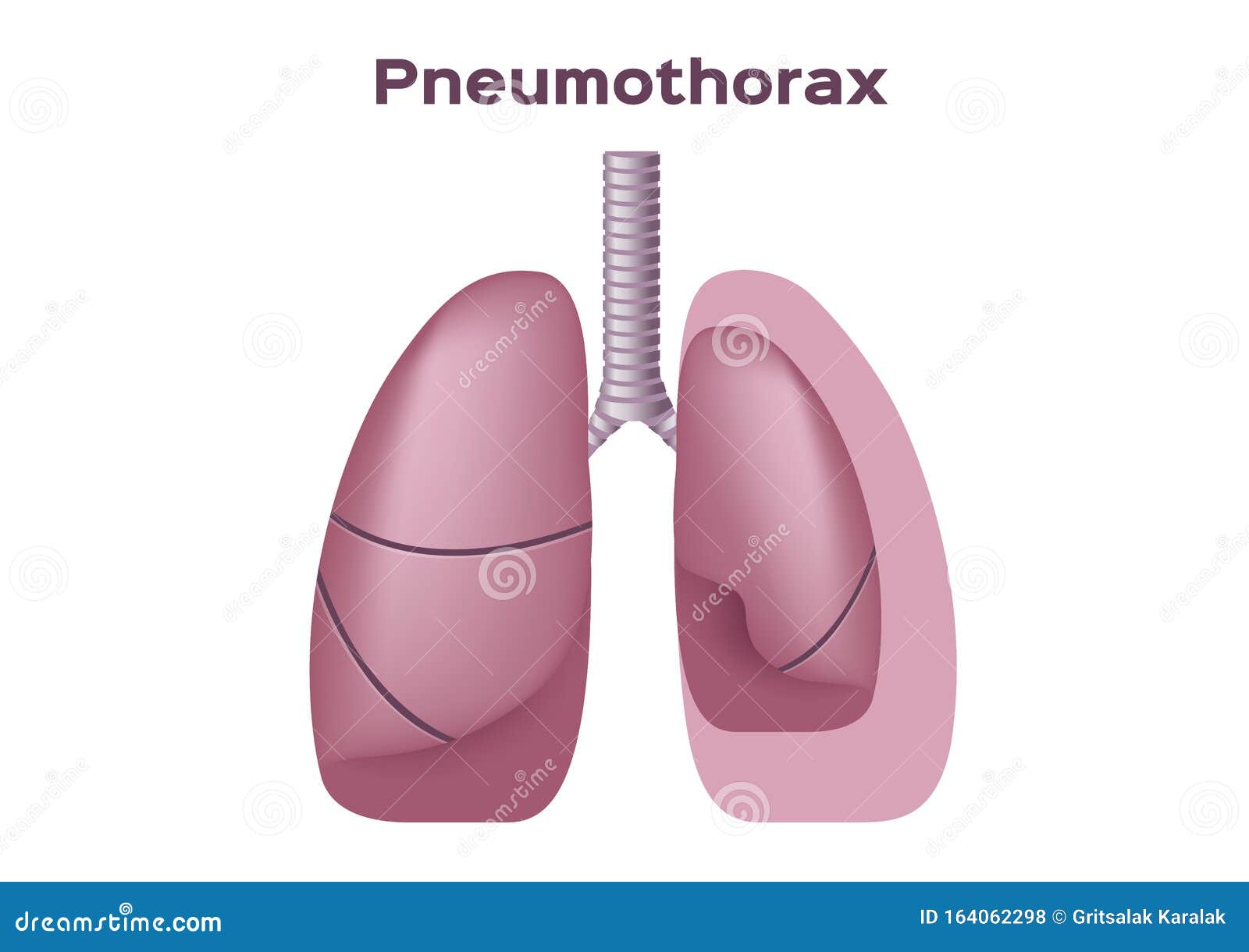 A Symptoms Of Pneumothorax Lung Stock Vector - Illustration of biology ...
