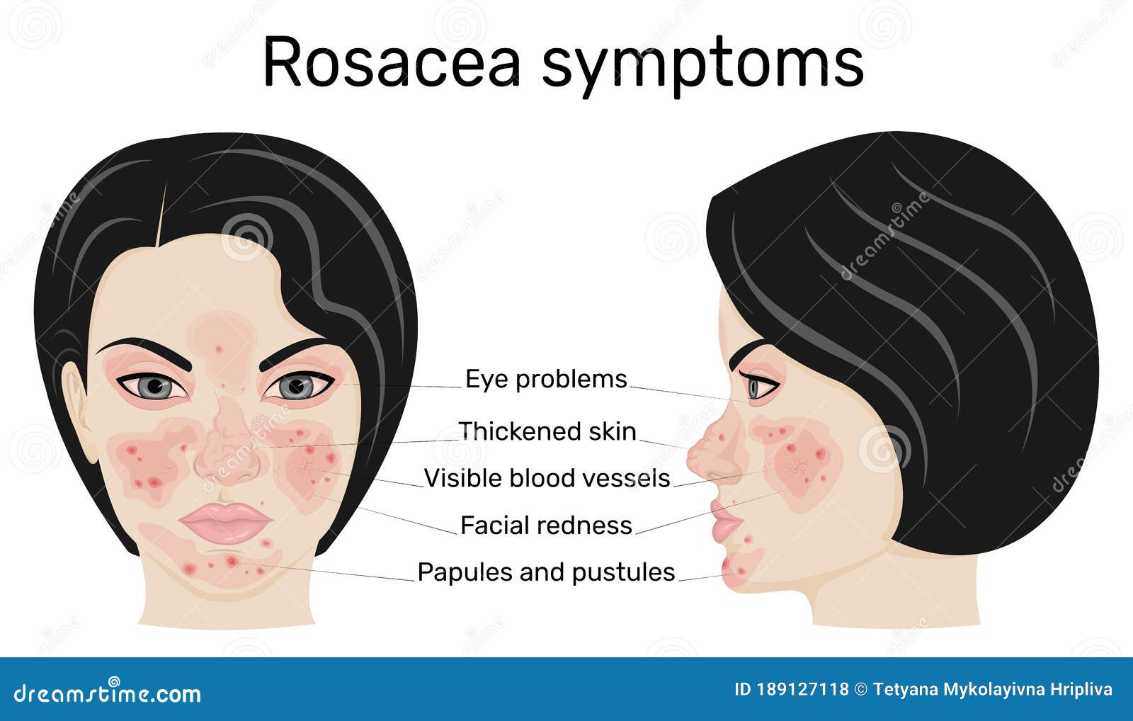 Symptoms of Rosacea stock vector. Illustration of healthcare - 189127118