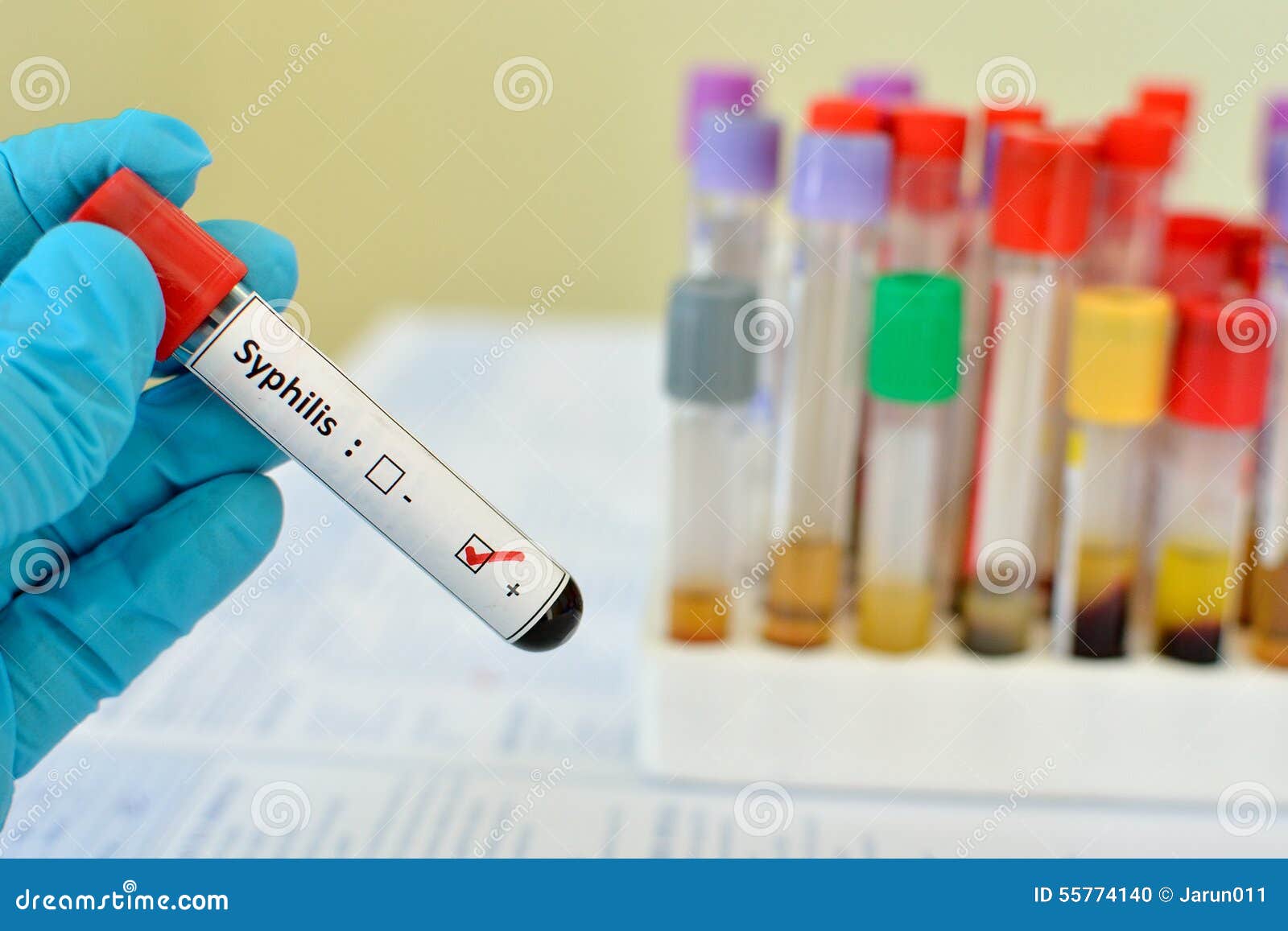 Syphilis positive stock photo. Image of sickness, patient - 55774140
