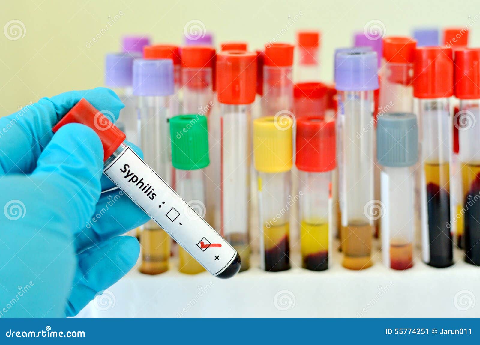Syphilis positive stock image. Image of patient, microbiology - 55774251