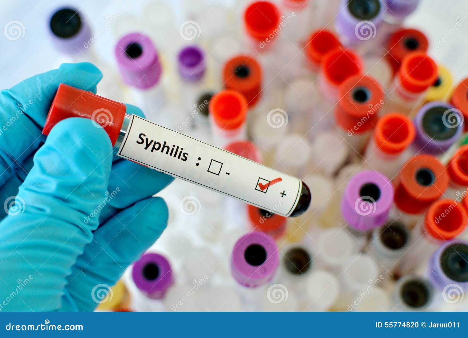 Syphilis positive stock photo. Image of experiment, sick - 55774820