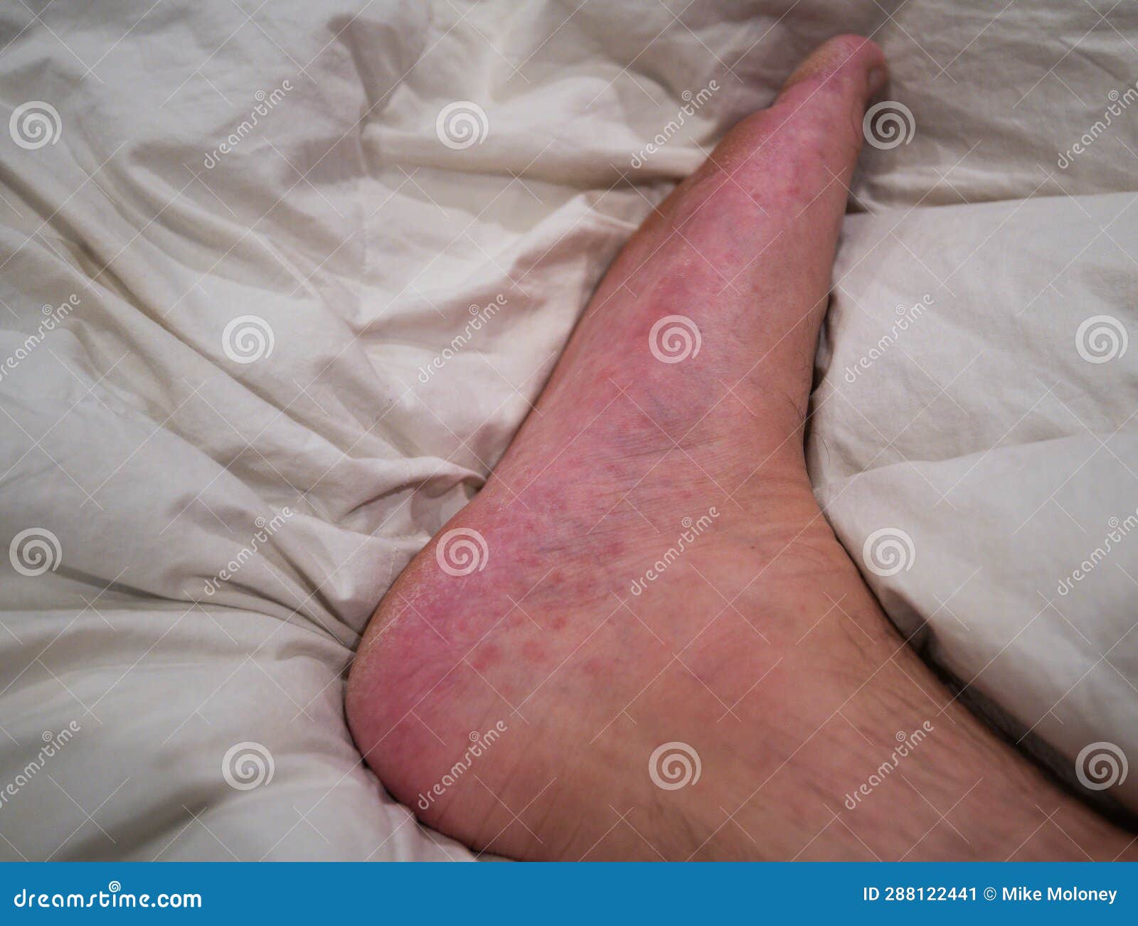 Syphilis Rash. Reddish Dots on Bottom of Foot Stock Image - Image of ...