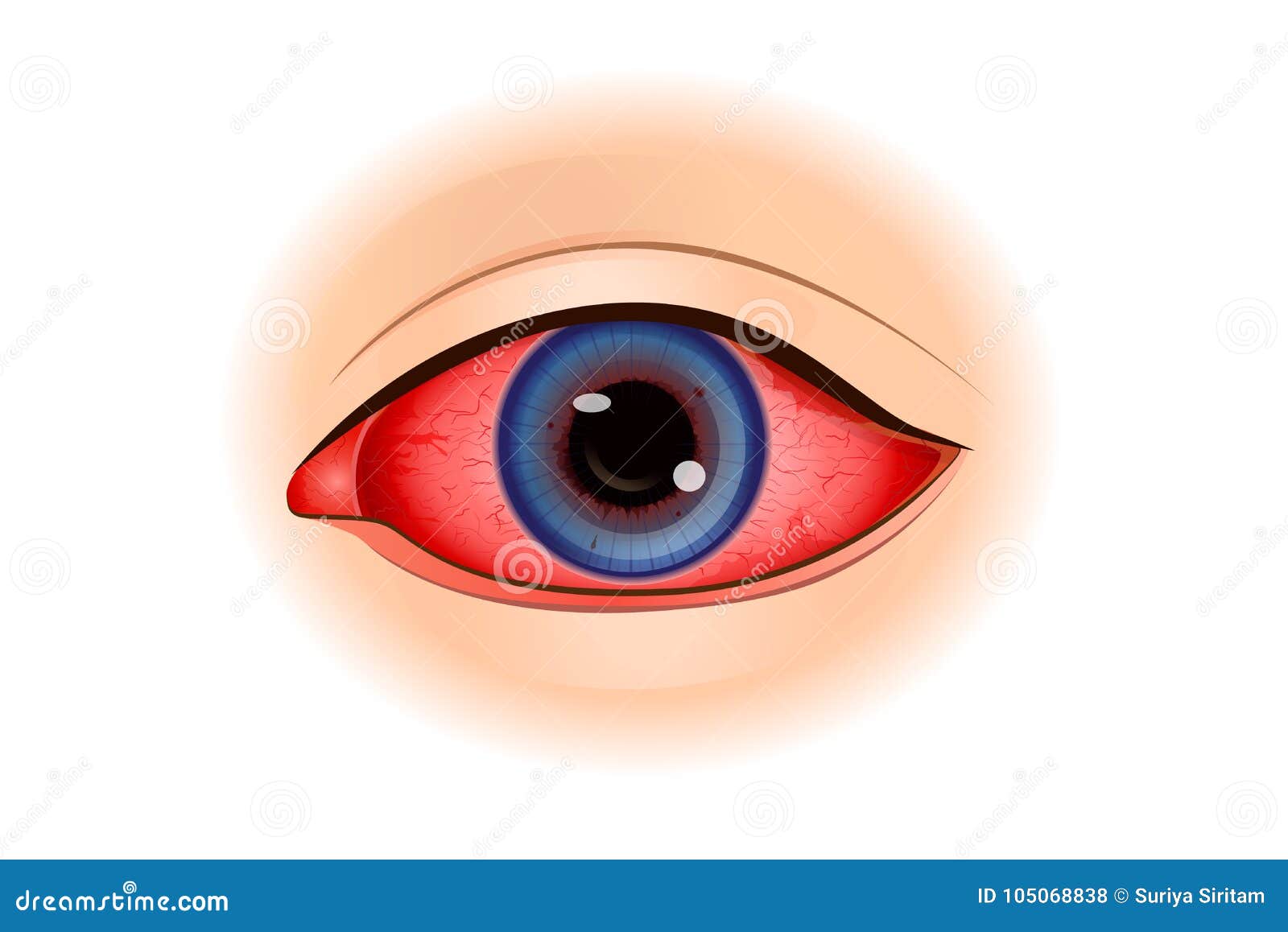 Síntomas De Uveitis O Inflamación Del Ojo Ilustración Del Vector