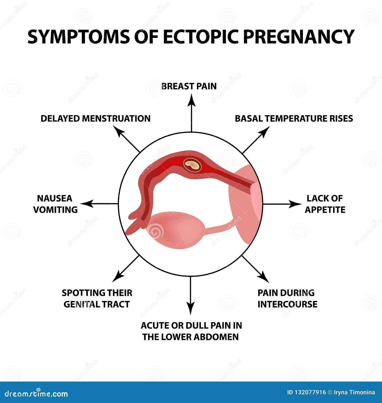 Síntomas Del Embarazo Ectópico Infografía Ejemplo Del Vector En Fondo