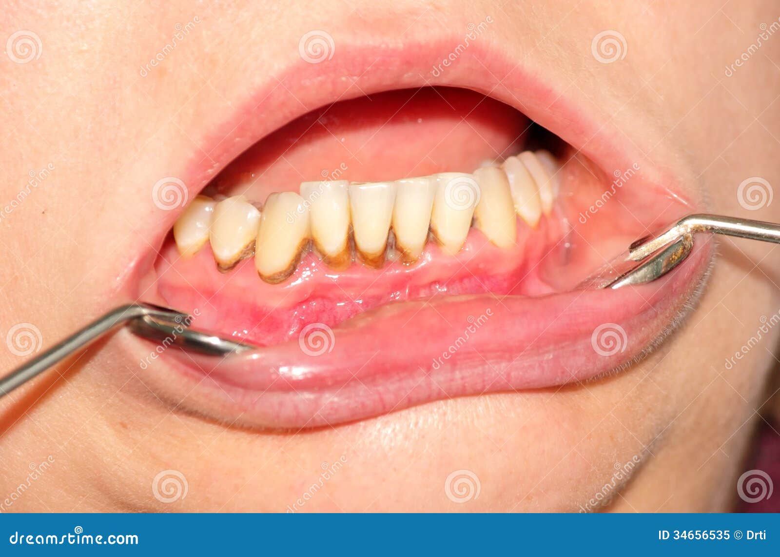 Tártaro e chapa dental imagem de stock. Imagem de dentadura - 34656535