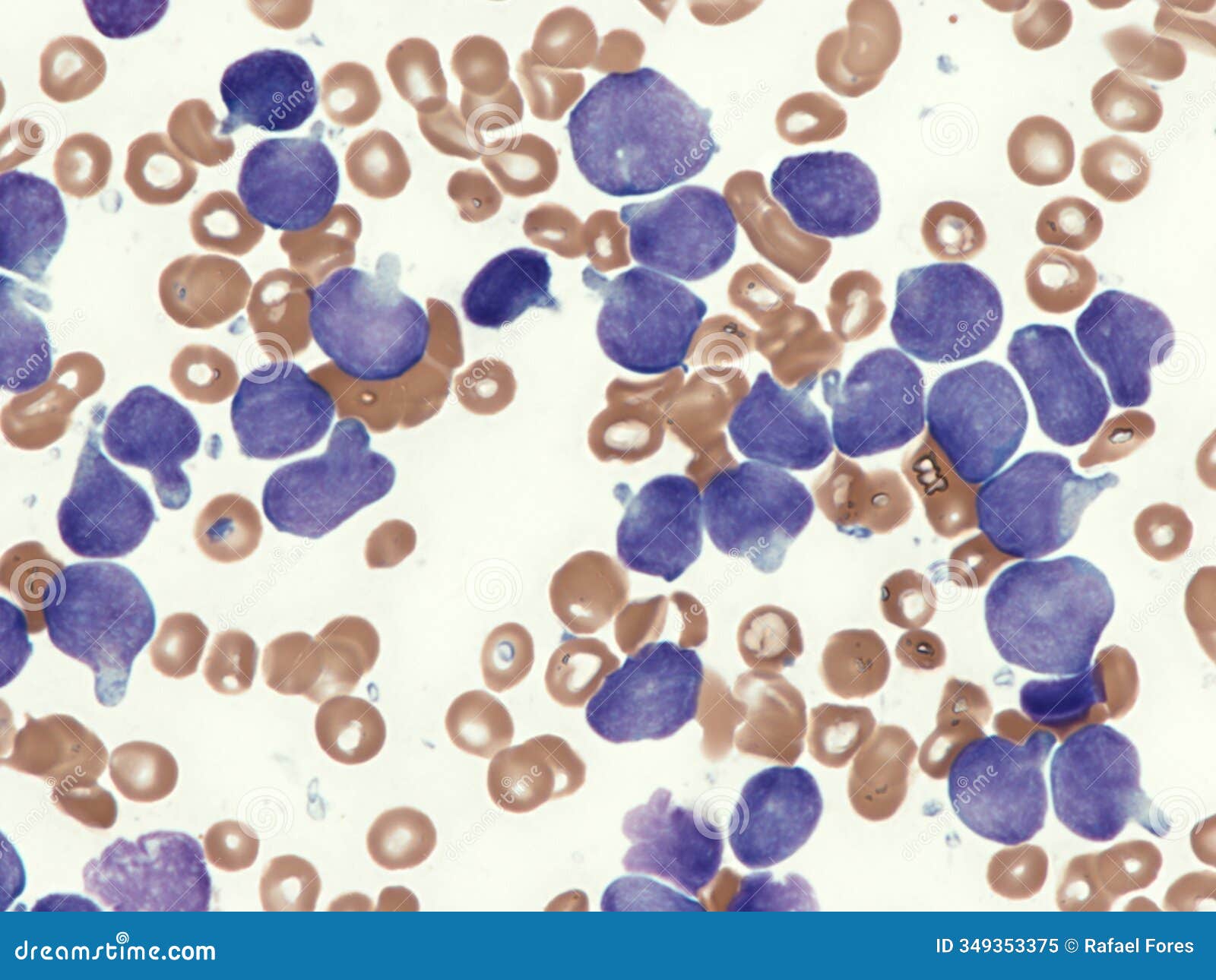 T-cell Acute Lymphoid Leukemia. Bone Marrow. Stock Image - Image of ...