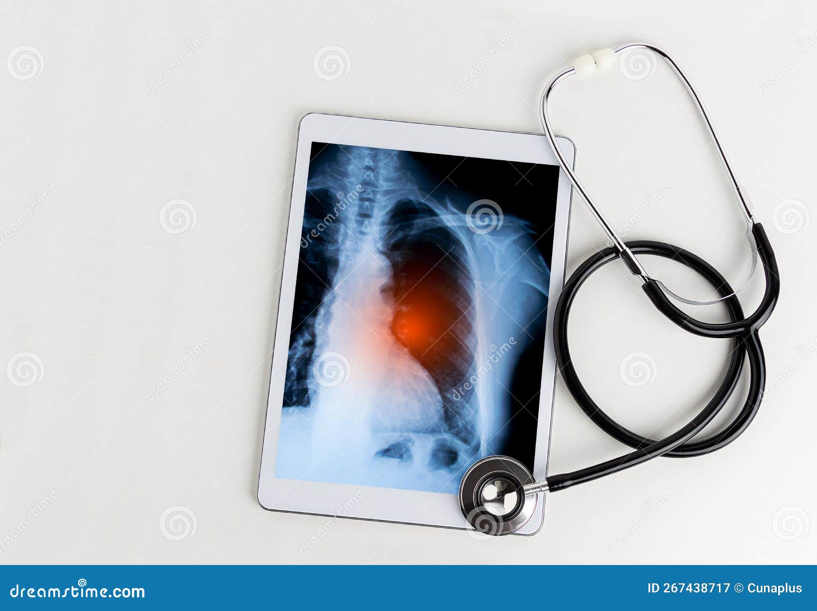 Tablet with an X-ray of a Lung and a Stethoscope Stock Image - Image of ...
