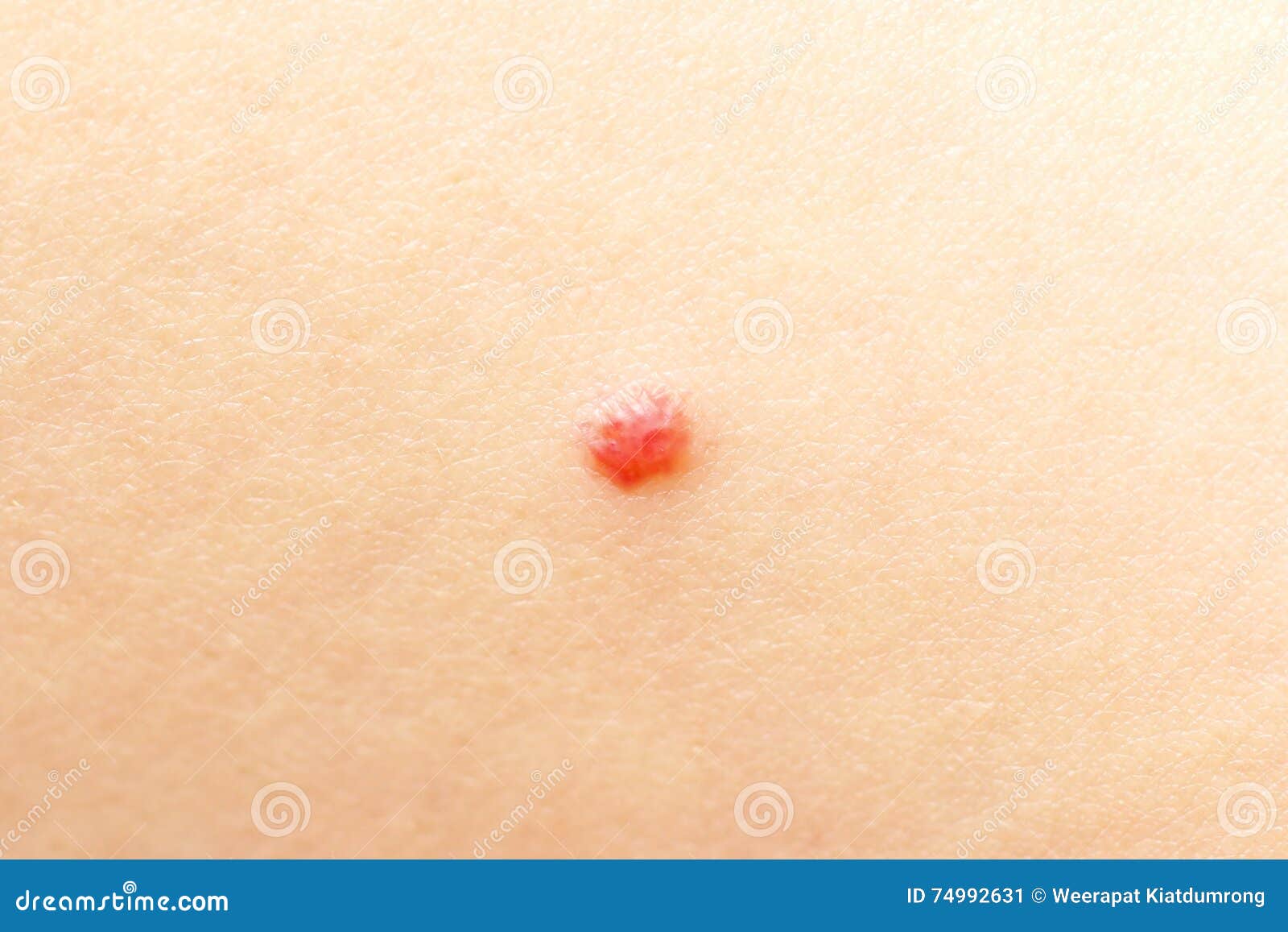 Tache rouge sur la peau image stock. Image du récipients - 74992631