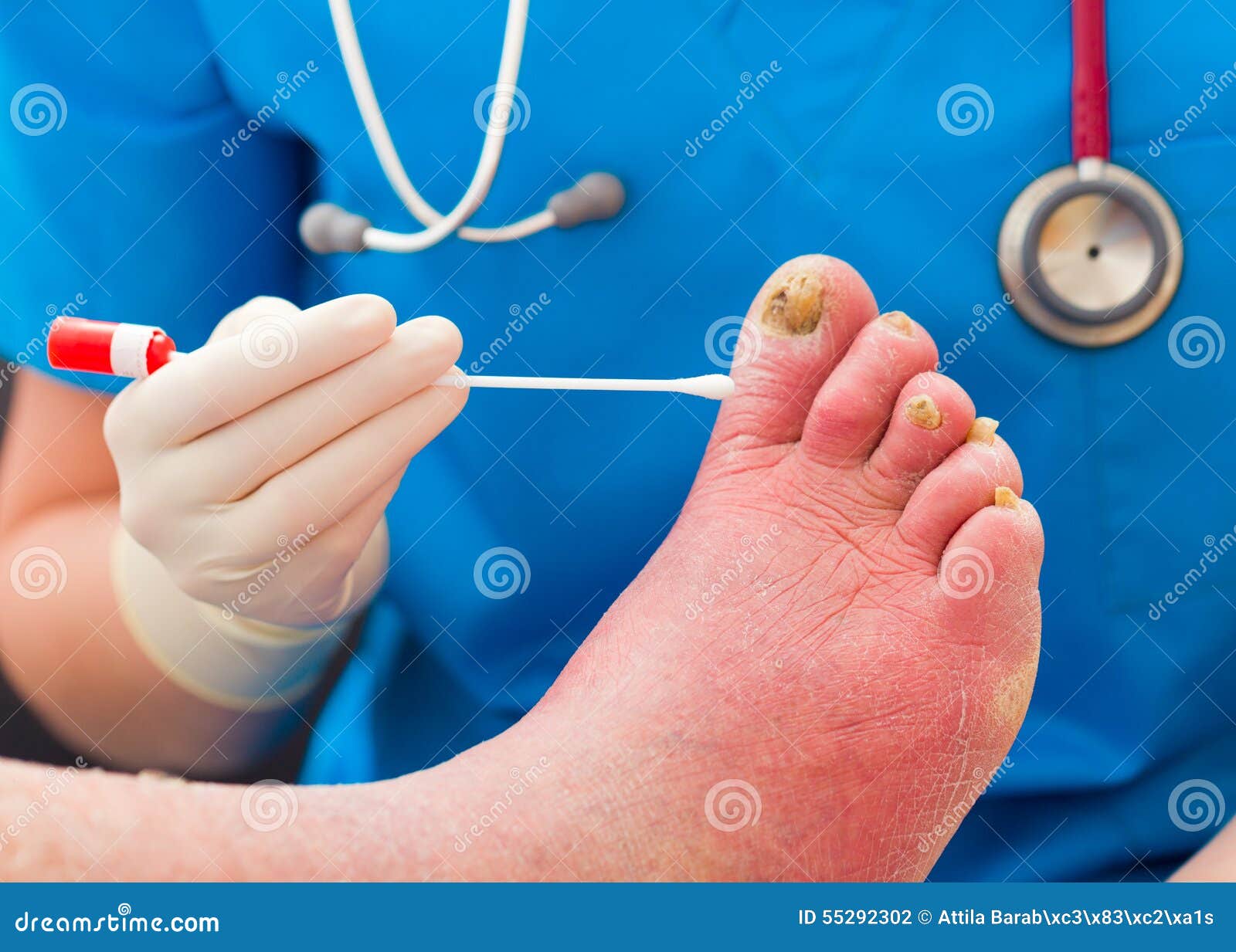 Taking Sample from Nail Fungus Stock Photo - Image of infected, patient ...