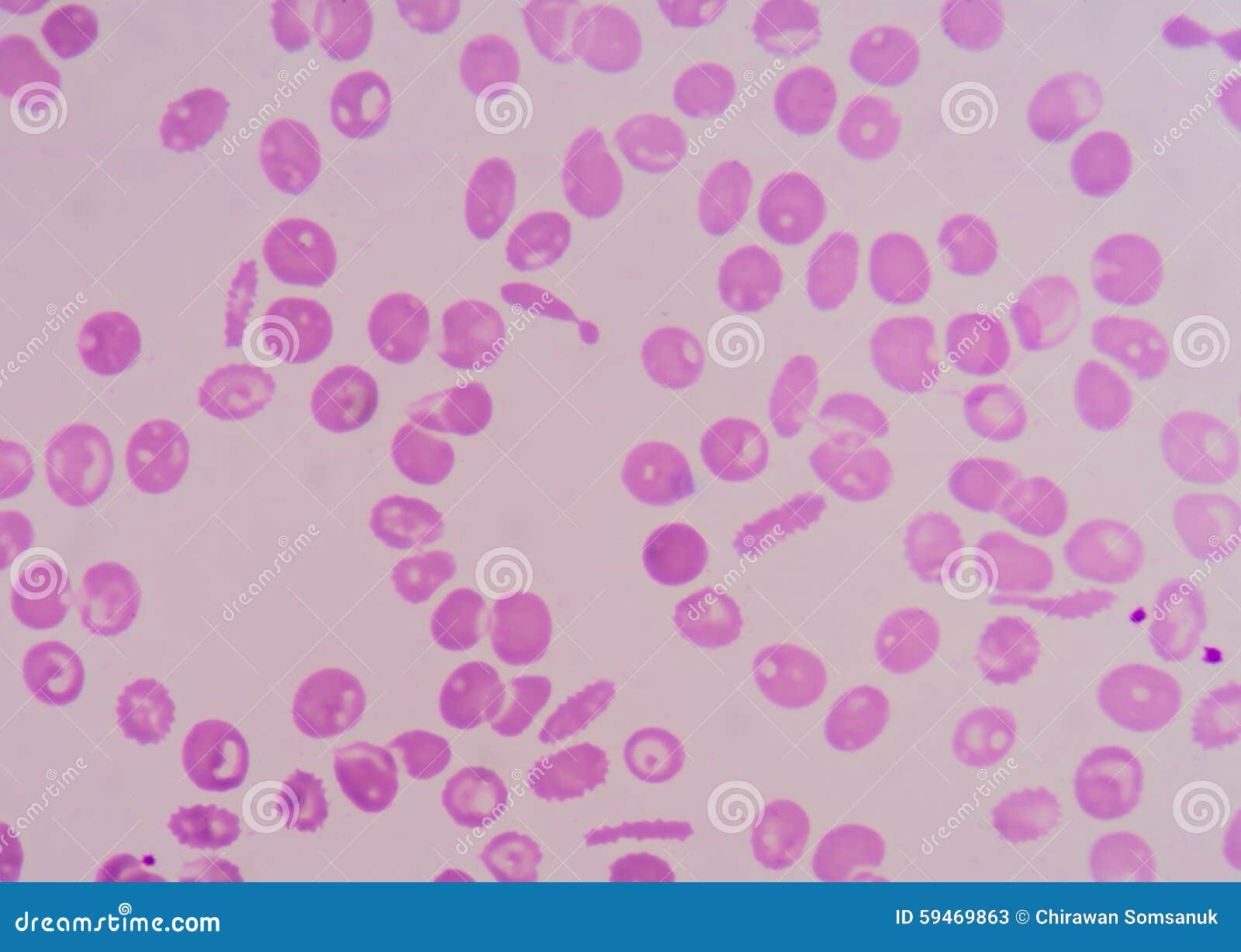 Talasemia imagen de archivo. Imagen de sistema, hemoglobina - 59469863