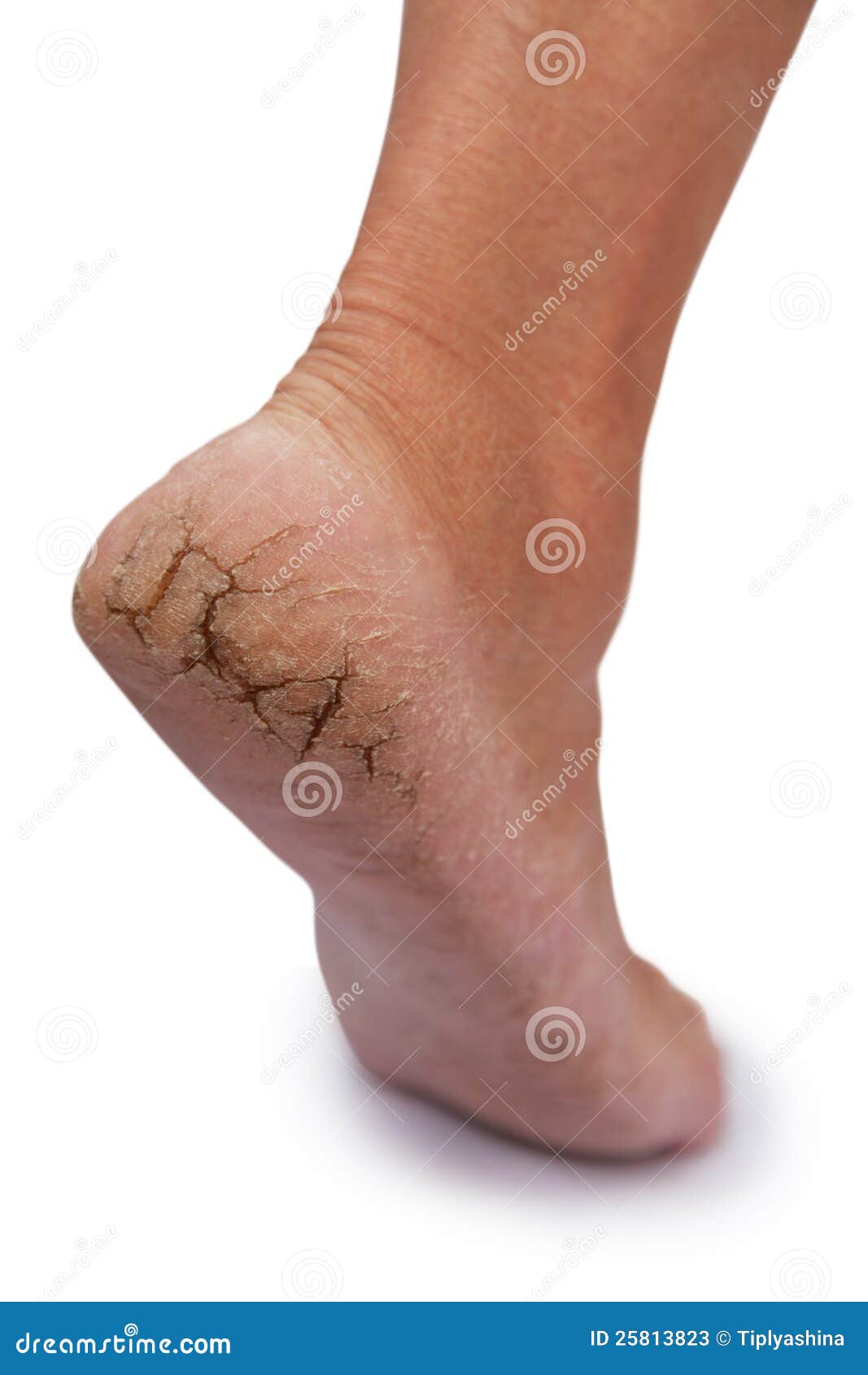 Talon gercé image stock. Image du négligé, effondrement - 25813823