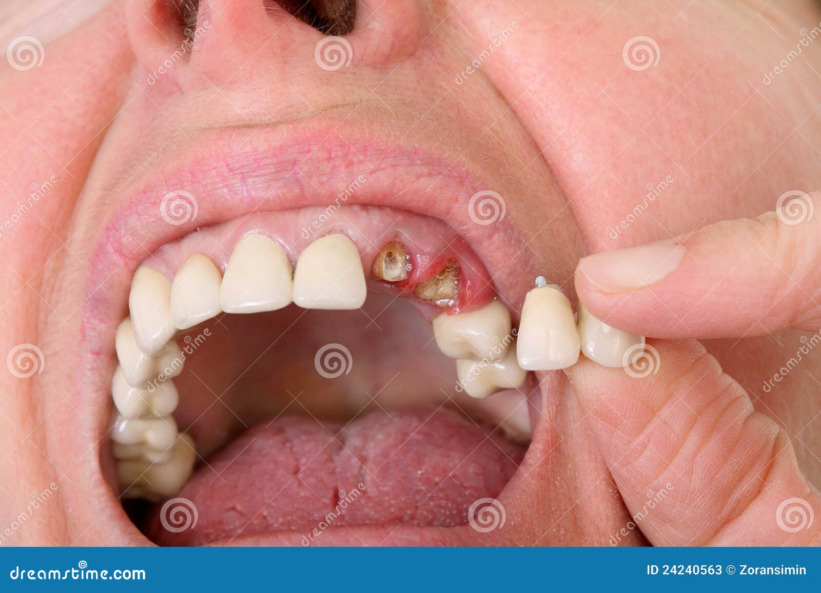 Tand- fotografering för bildbyråer. Bild av bridgetown - 24240563