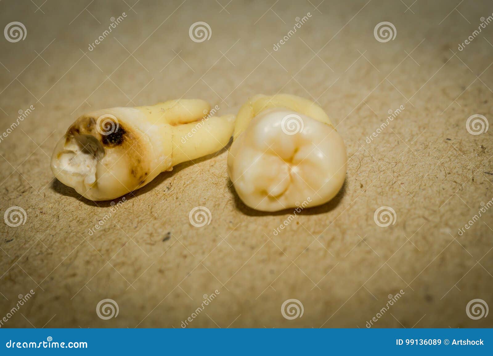 Tand efter extraktion fotografering för bildbyråer. Bild av hygien ...