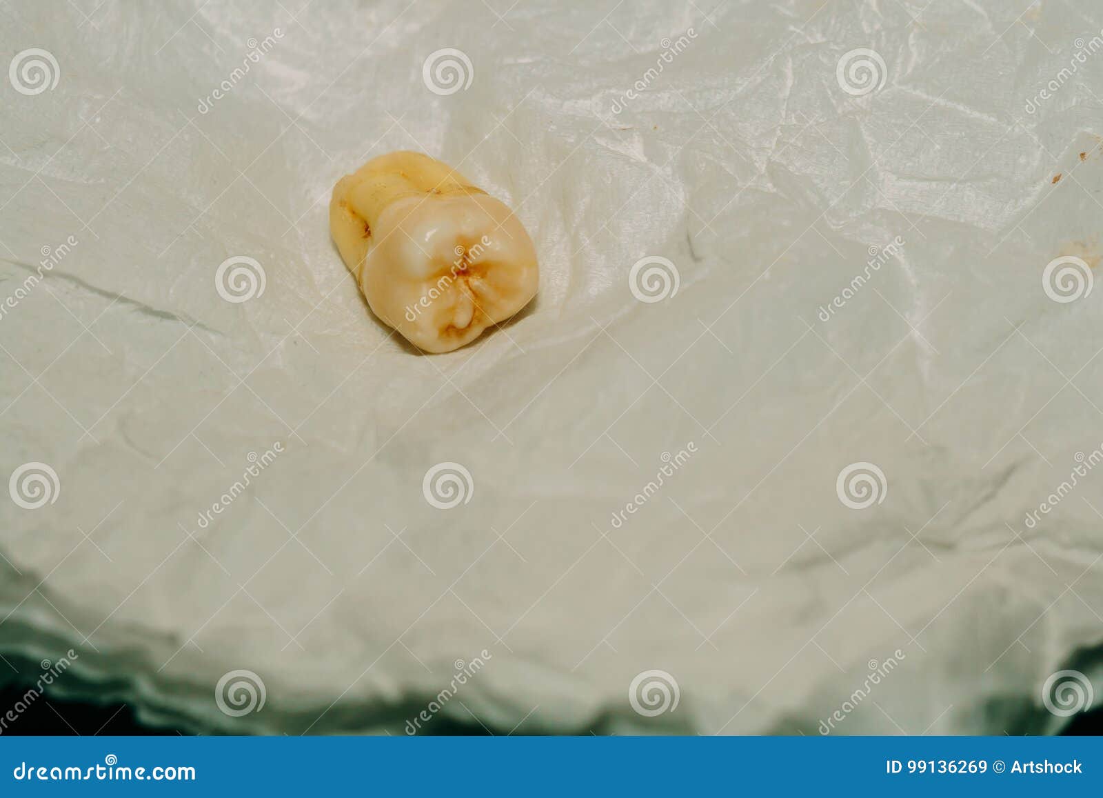 Tand efter extraktion fotografering för bildbyråer. Bild av förfall ...