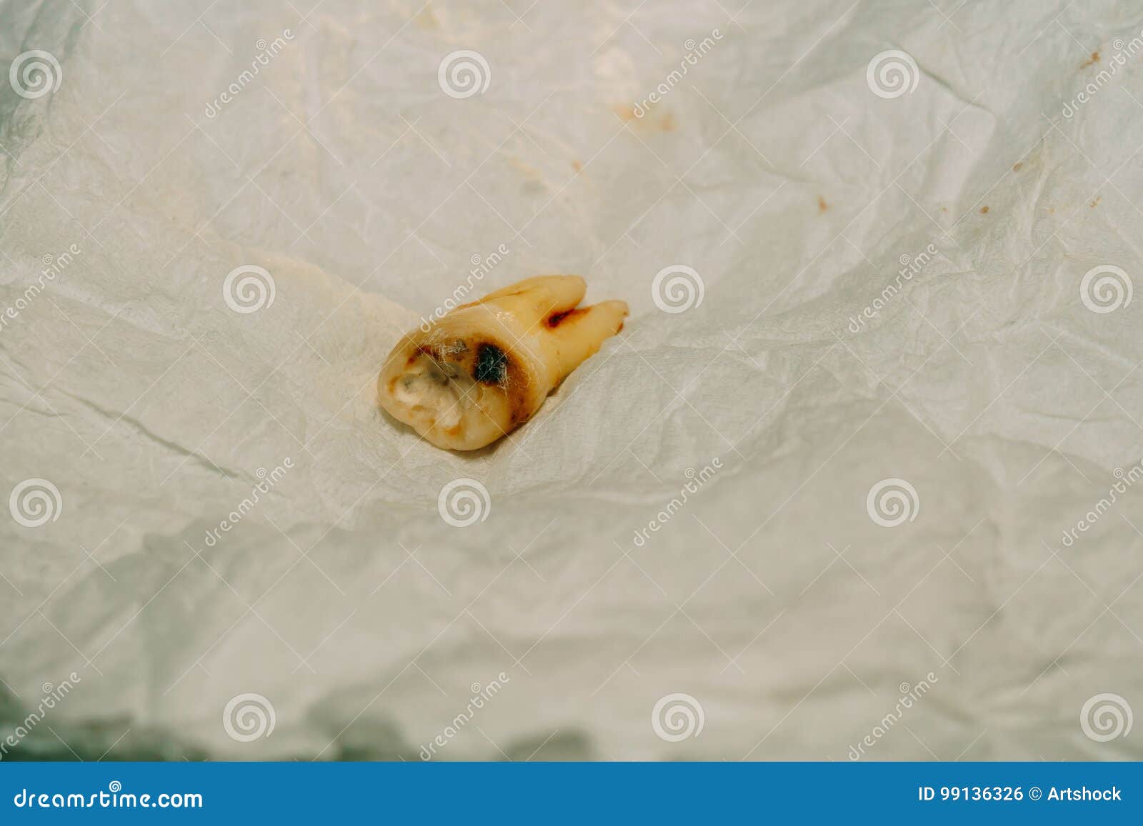 Tand efter extraktion arkivfoto. Bild av stängning, tandvärk - 99136326