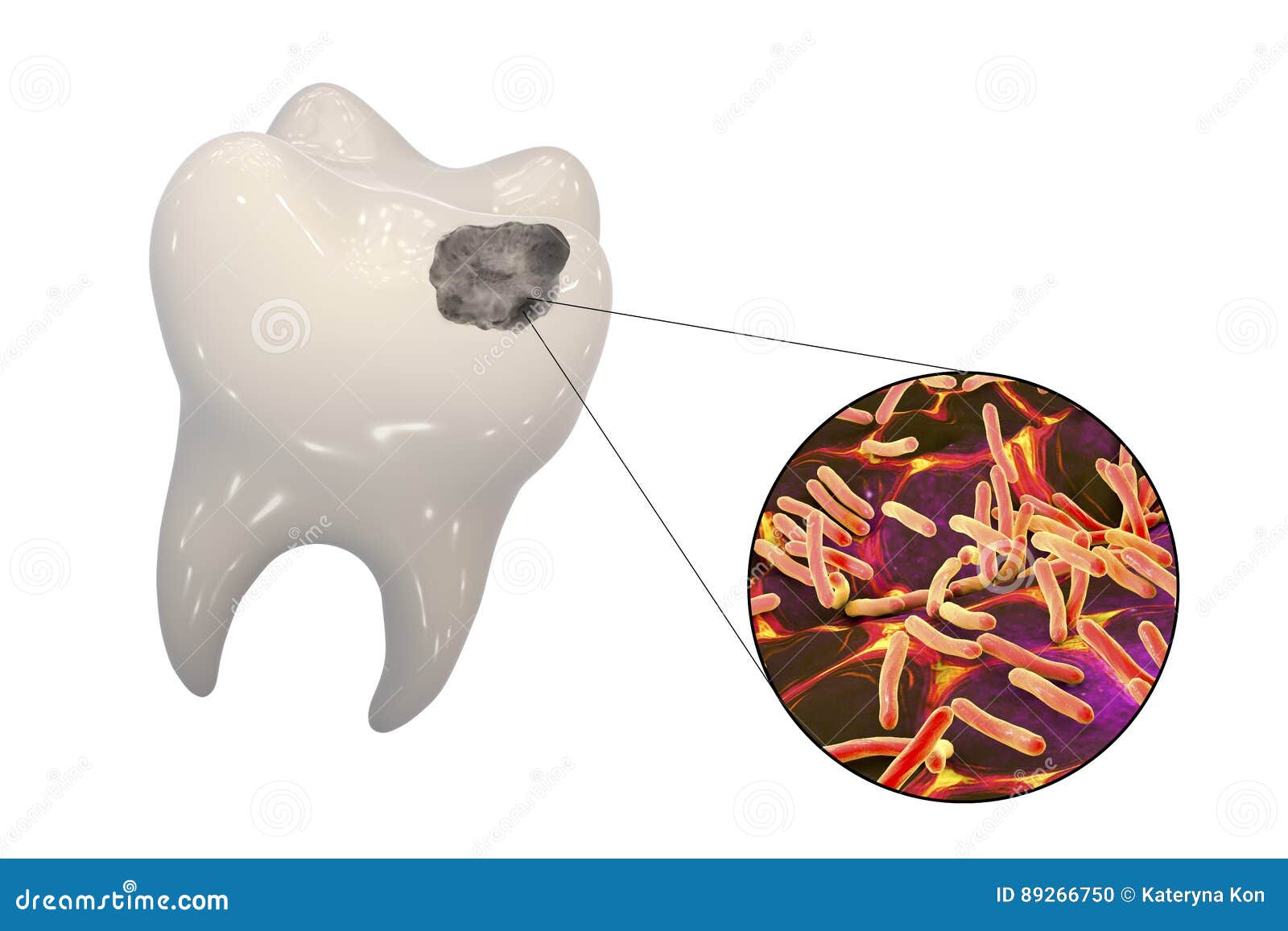 Tand met tandbederf stock illustratie. Illustration of tand - 89266750