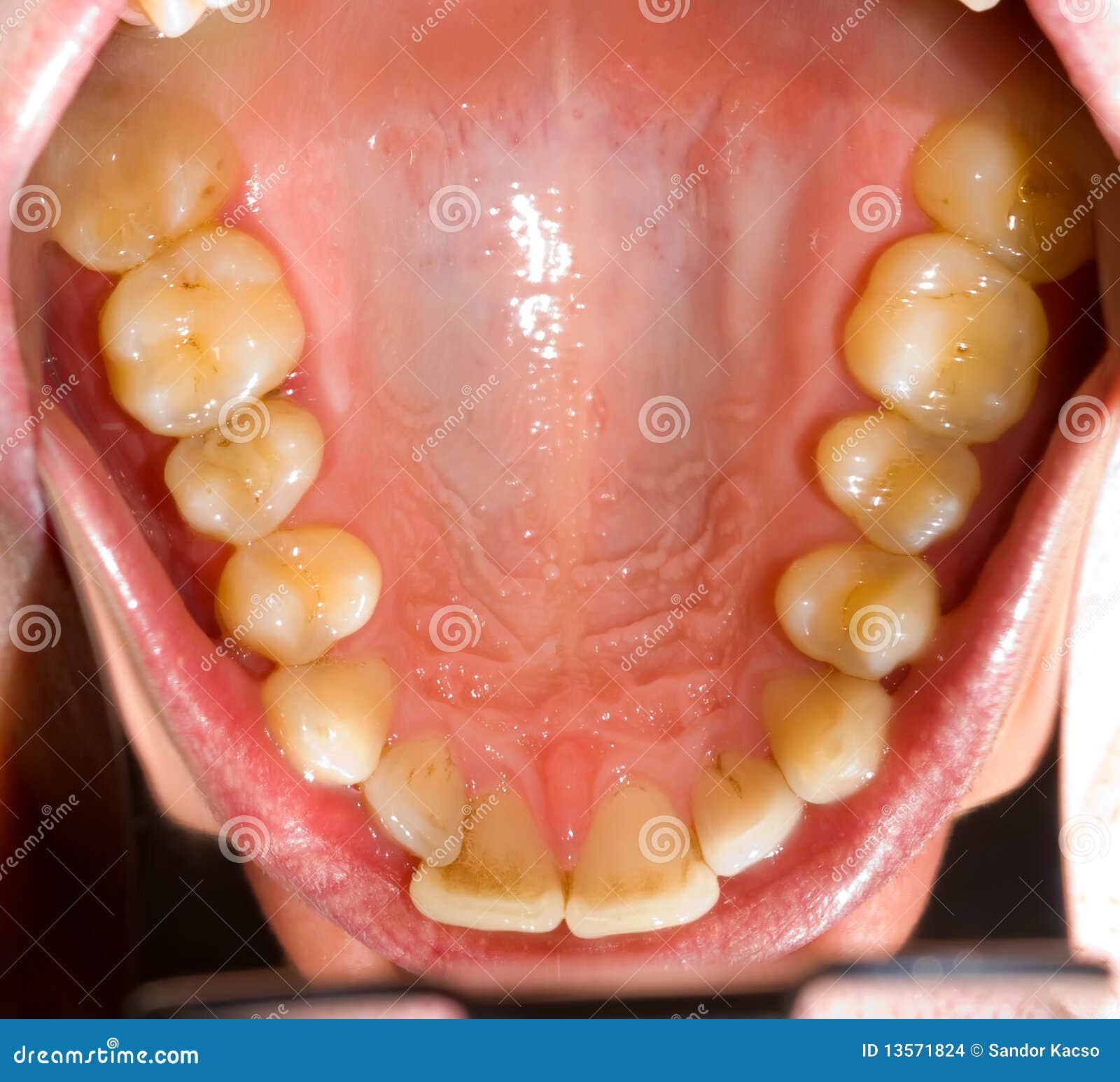 Tand photograpy stock foto. Image of tandheelkunde, macro - 13571824