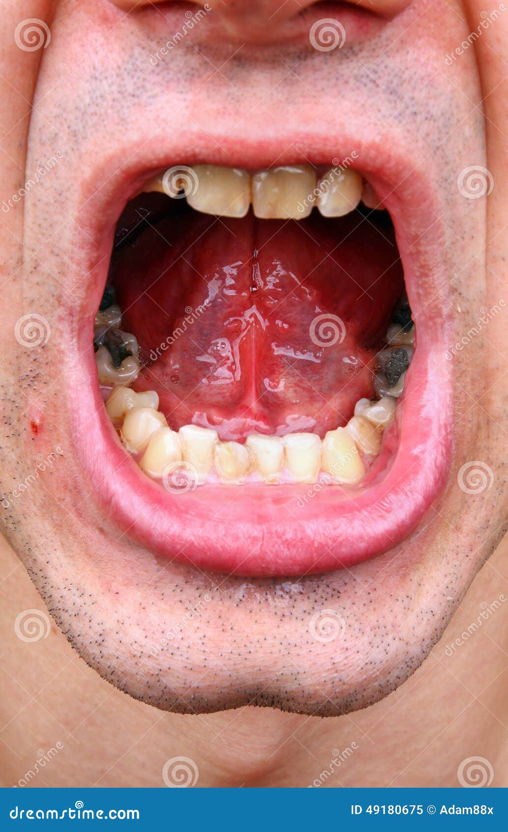 Tartar and tooth decay stock image. Image of mouth, gums - 49180675