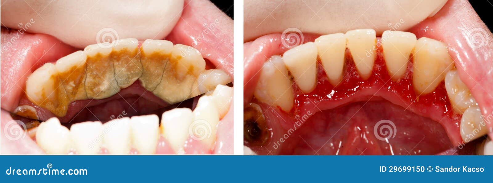 Tartre Massif Et Traitement Photo stock - Image du plaques, bouche ...