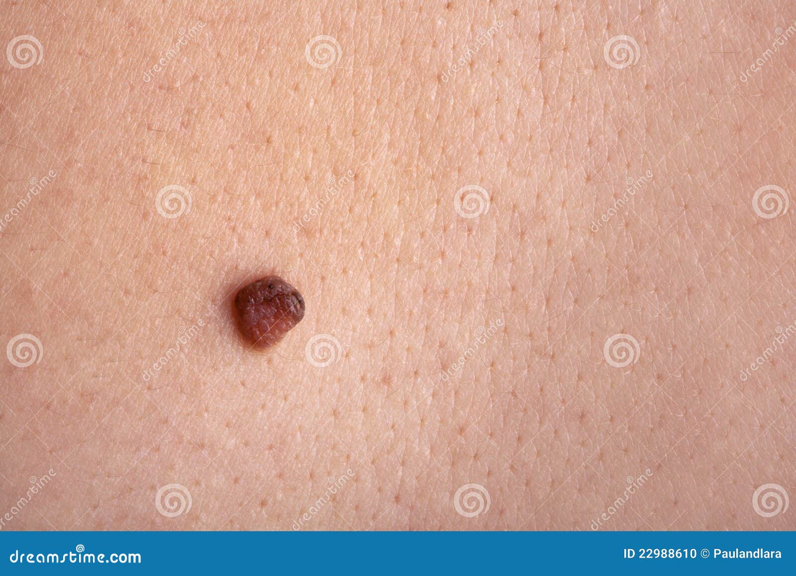 Taupe Sur La Peau Photos Stock - Téléchargez 649 Photos libres de droits