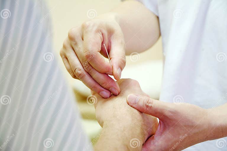 TCM stock photo. Image of therapy, powerful, hand, needles - 2425466