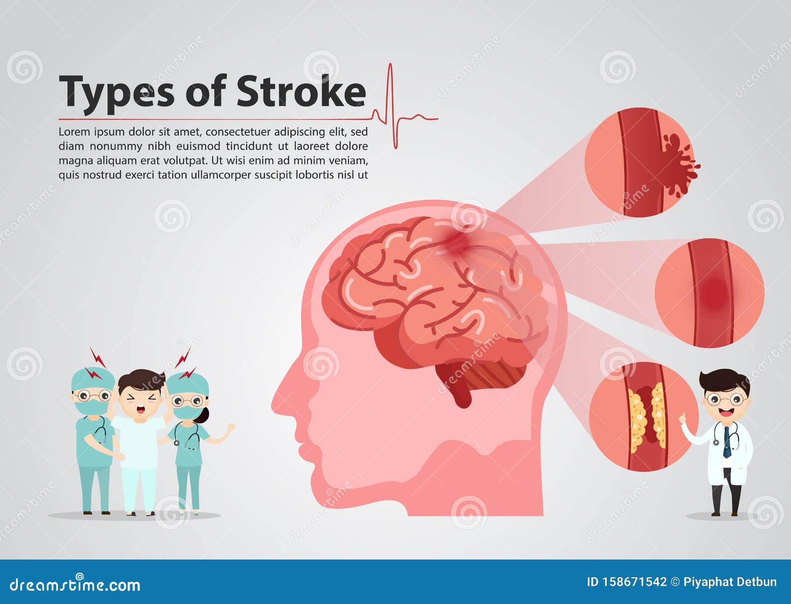 Scientific Medical Illustration of Human Brain Stroke Illustration ...