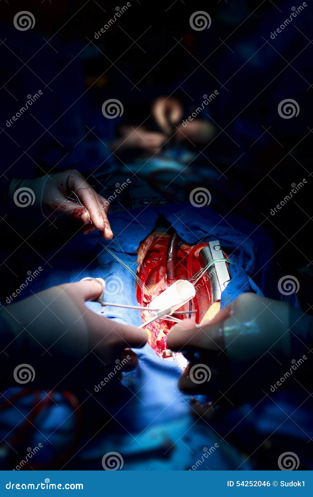 Open Heart Surgery Suture Greater Saphenous Coronary Artery Bypass ...