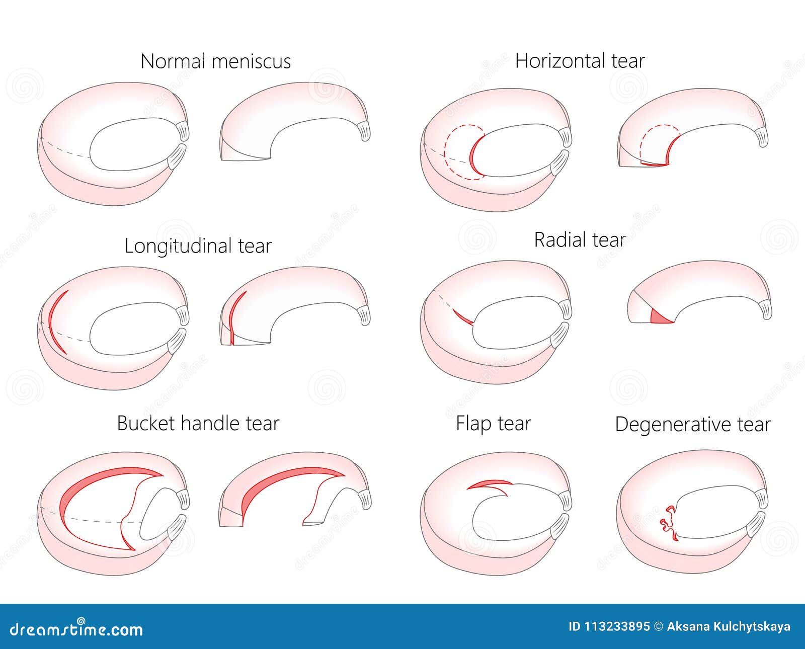 Menisk Stock Illustrationer, Vektorer, & Clipart – (23 Stock ...