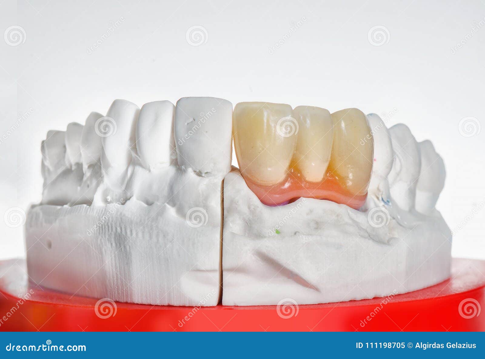 Technical Shots of Tooth Prosthesis on a Dental Prothetic Laboratory ...