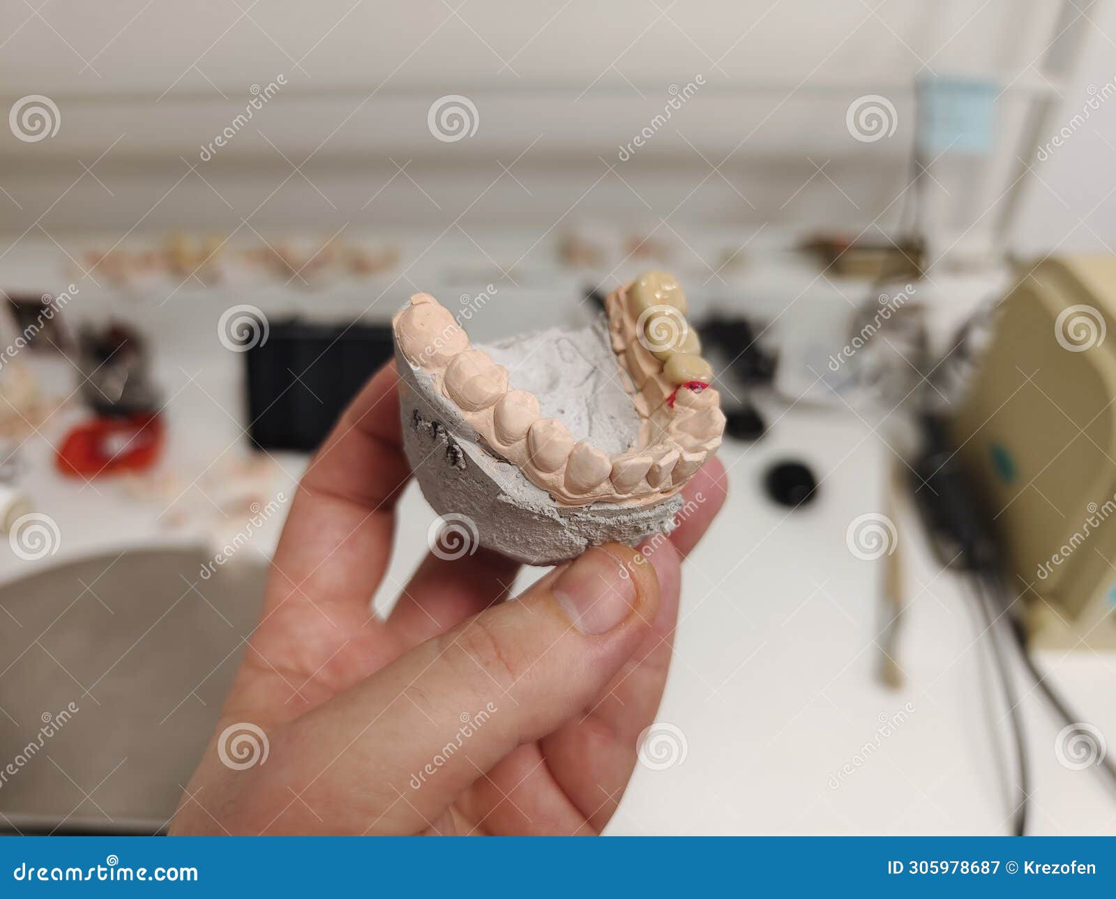 Technician Dental is Working with Complete Metal Ceramic Prosthesis ...